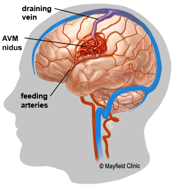 Avm Brain Symptoms