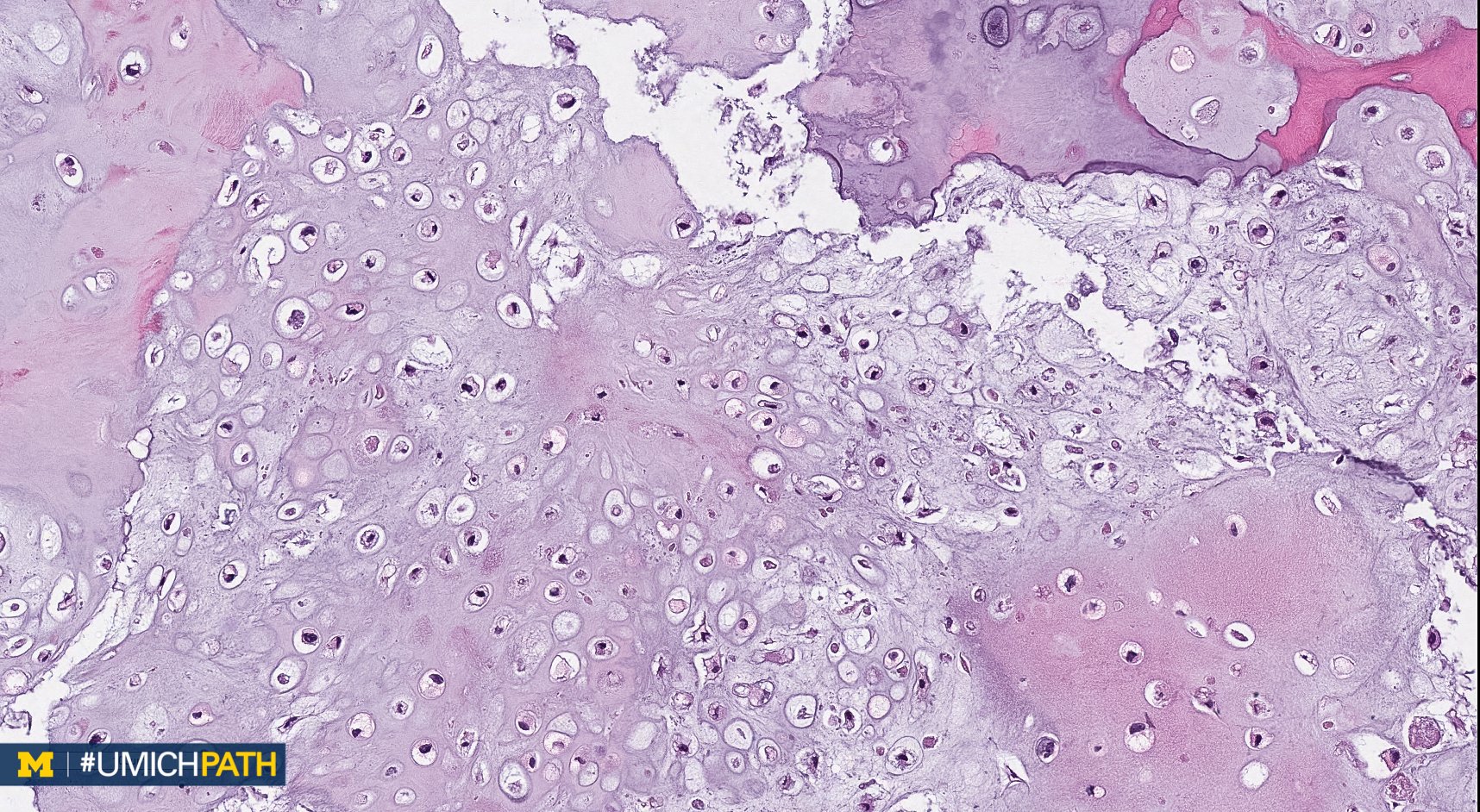Enchondroma Histology
