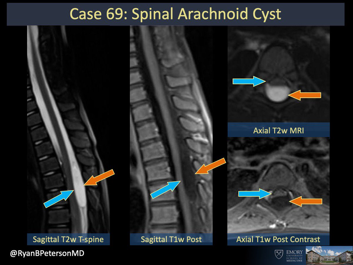Spinal Arachnoid Cyst