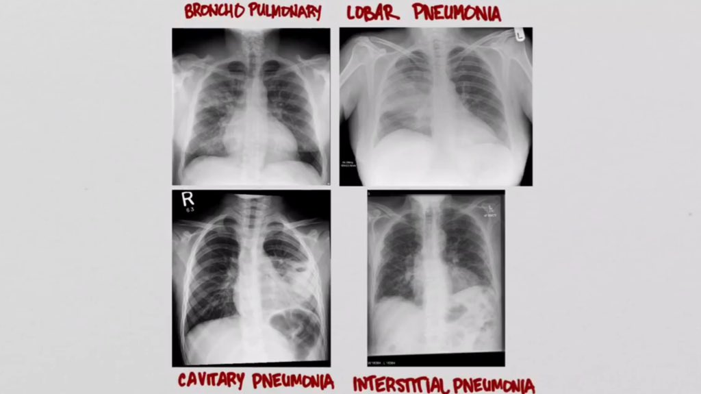 Bronconeumonía Vs Neumonía Lobar