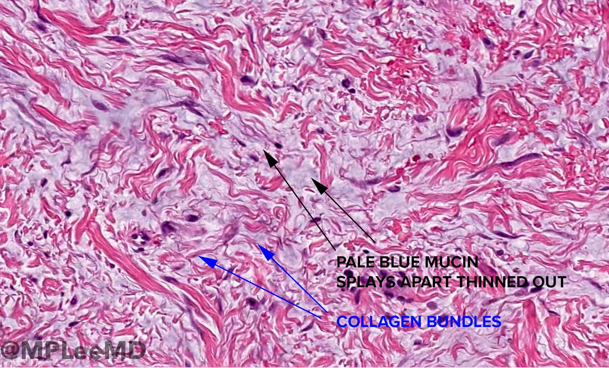 Pretibial Myxedema Pathology