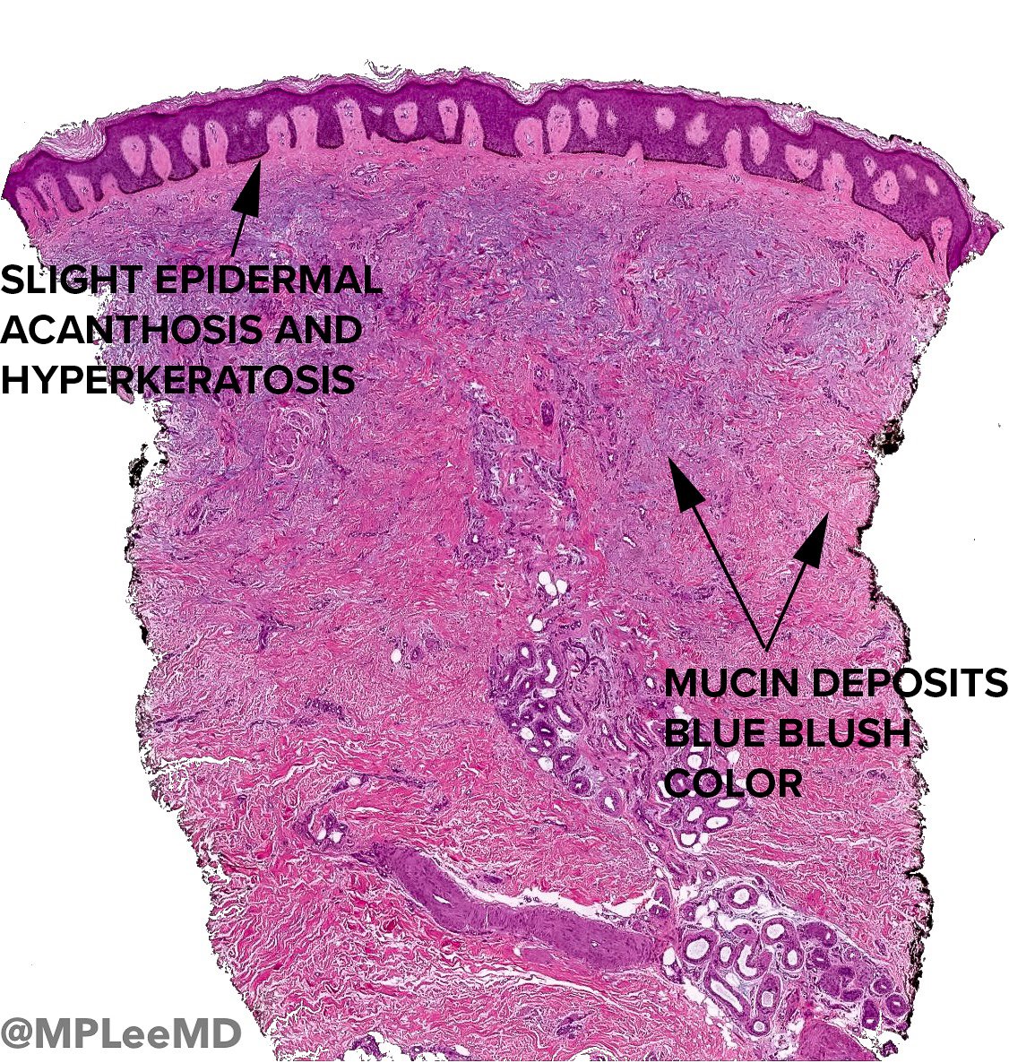 Pretibial Myxedema Pathology