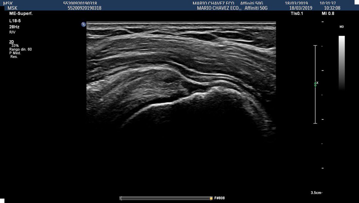 Common extensor tendon tear - The Ultrasound Site