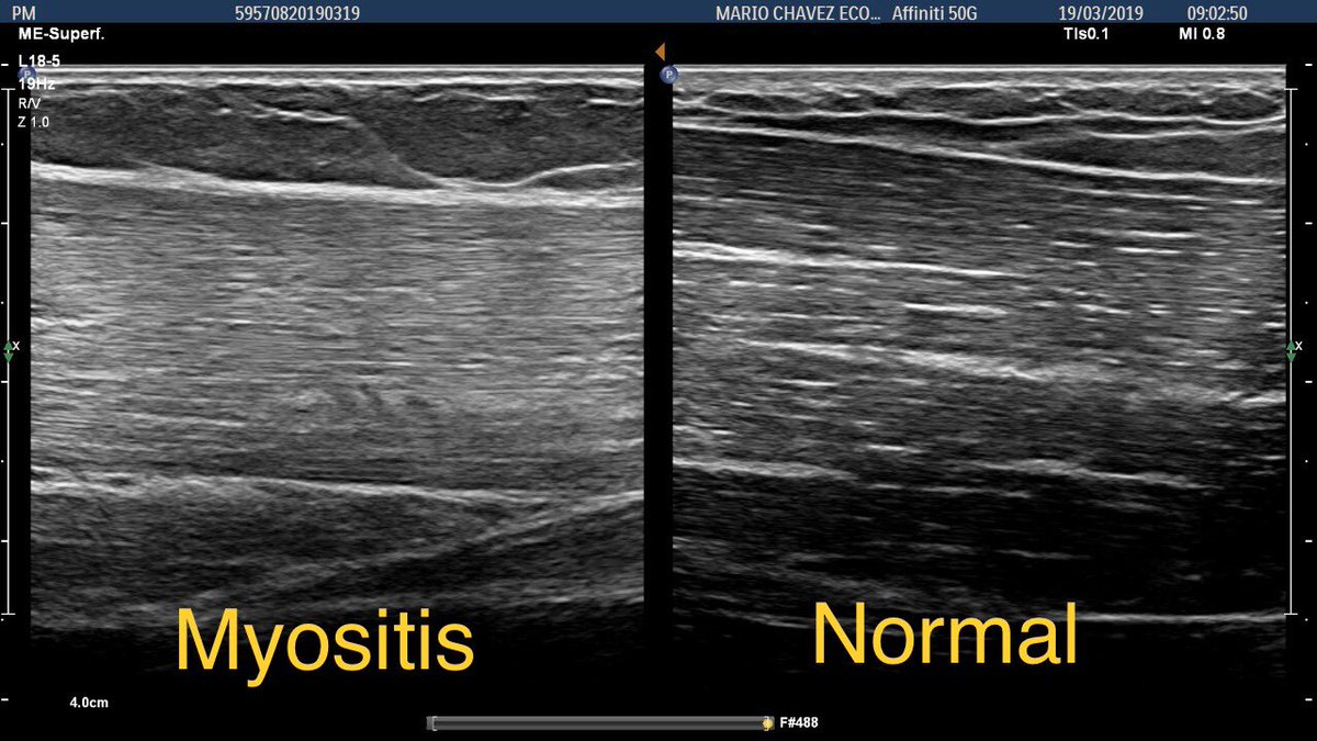 Common extensor tendon tear - The Ultrasound Site