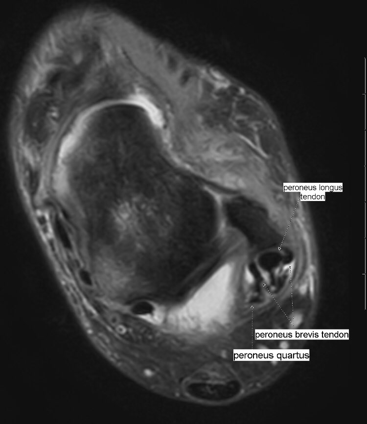 Peroneus Quartus Mri