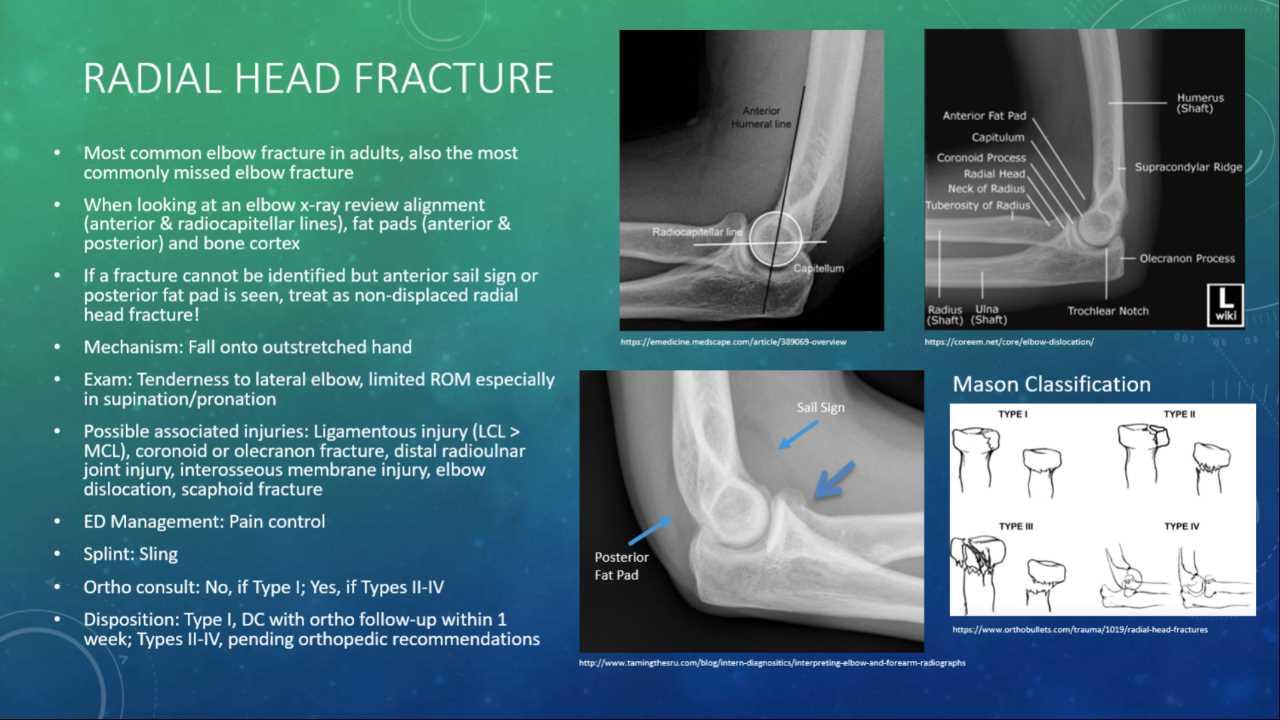Most Common Elbow Fracture