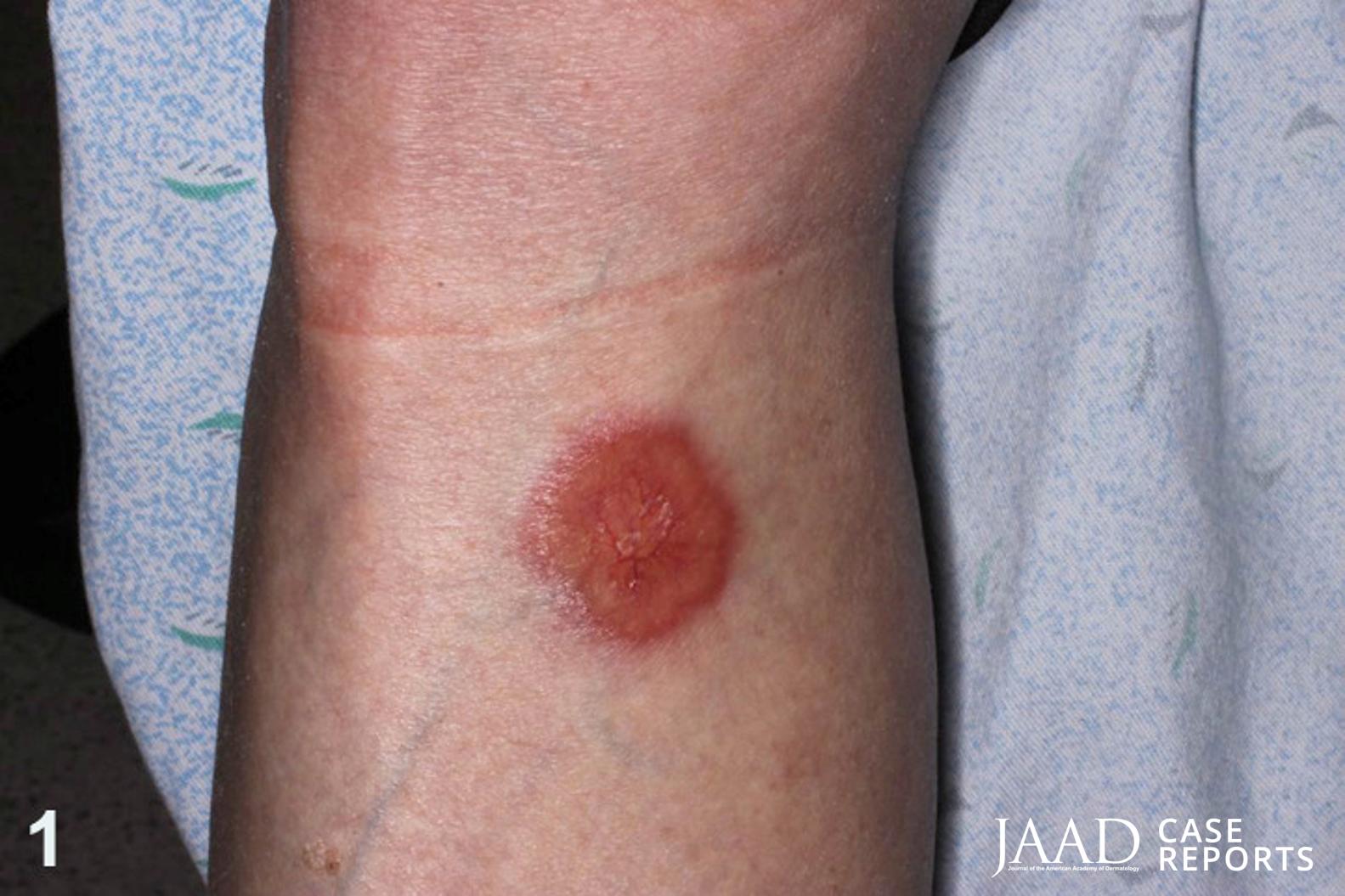 Necrobiotic Xanthogranuloma