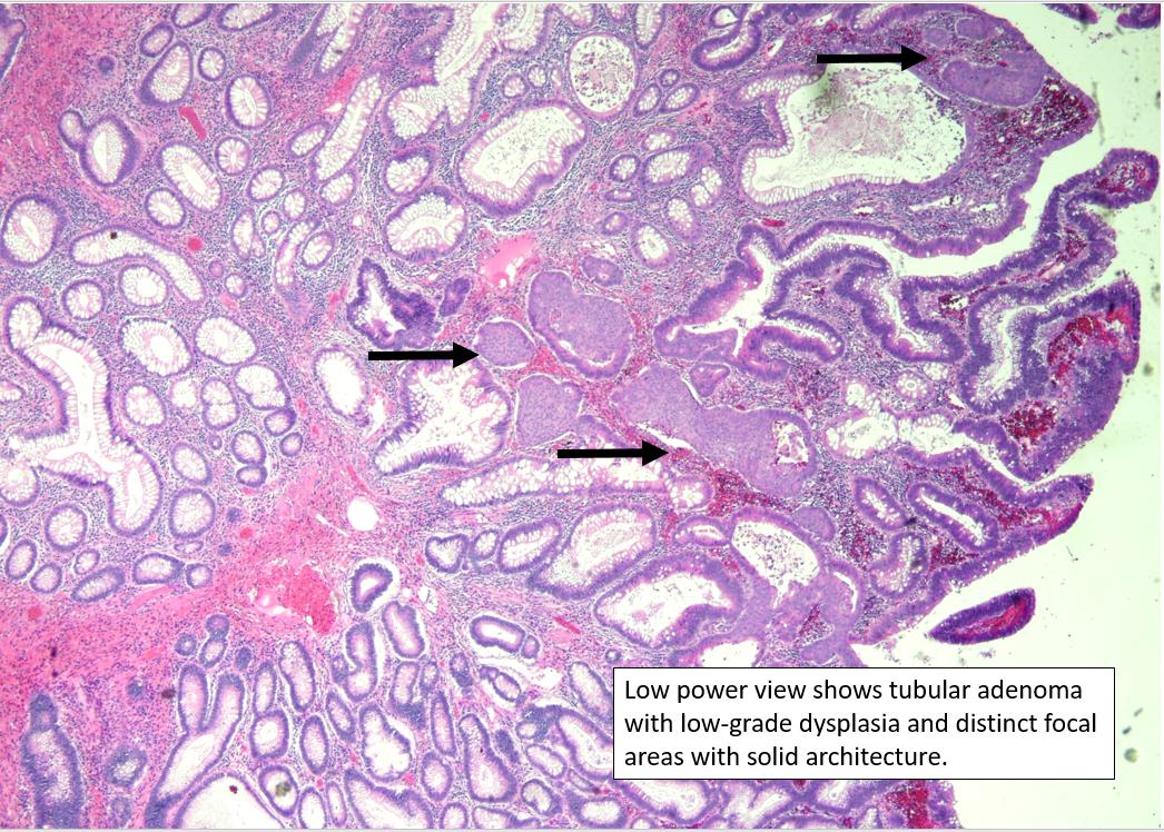 Tubular Adenoma