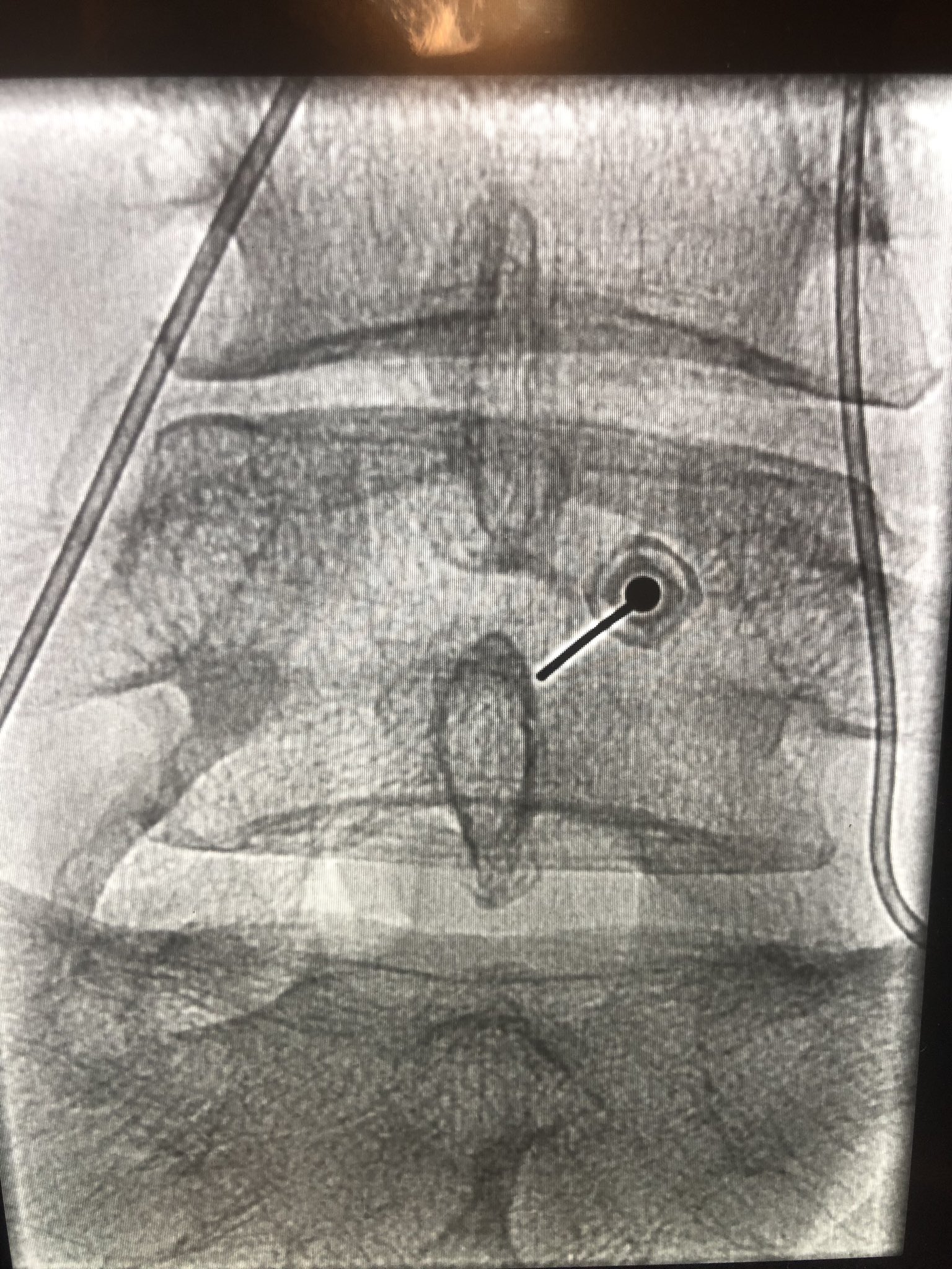 Hypogastric Nerve Block