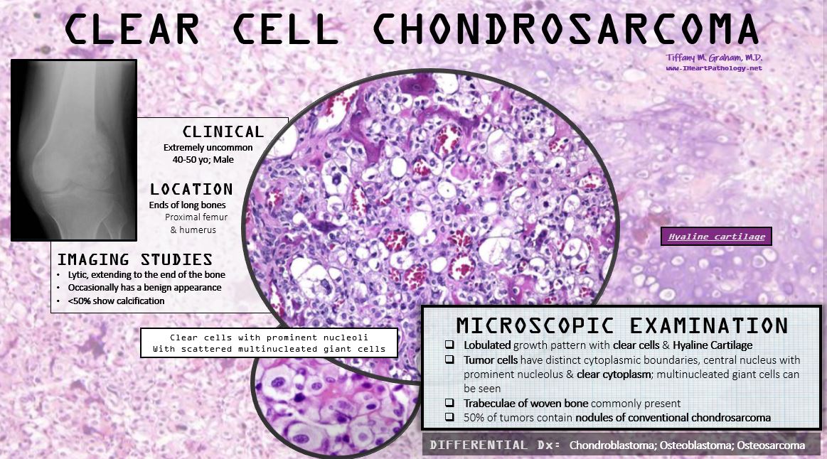 Osteosarcoma Histology Labeled