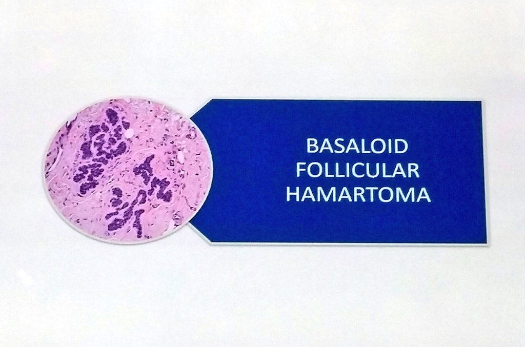 Basaloid Follicular Hamartoma