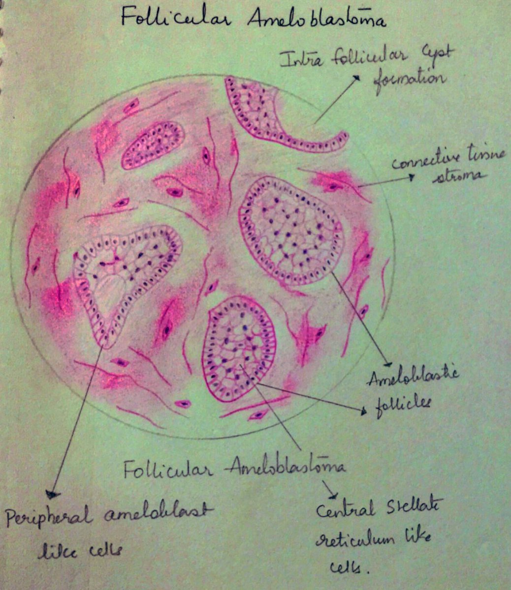 Peripheral Ameloblastoma Histology