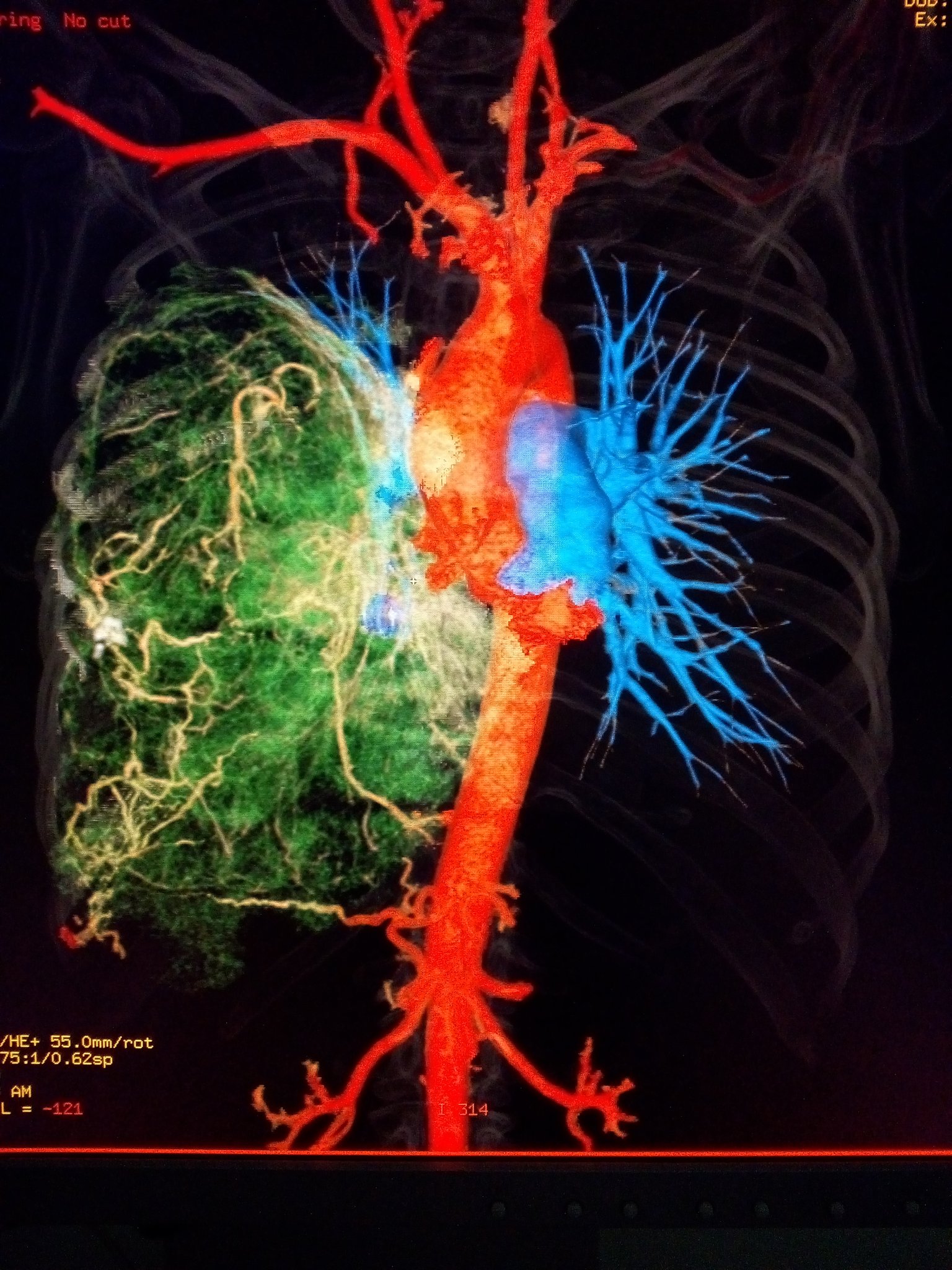 Hospital de Clínicas Caracas on Twitter: "La Angiografía por Tomografía Computarizada ayuda a ...