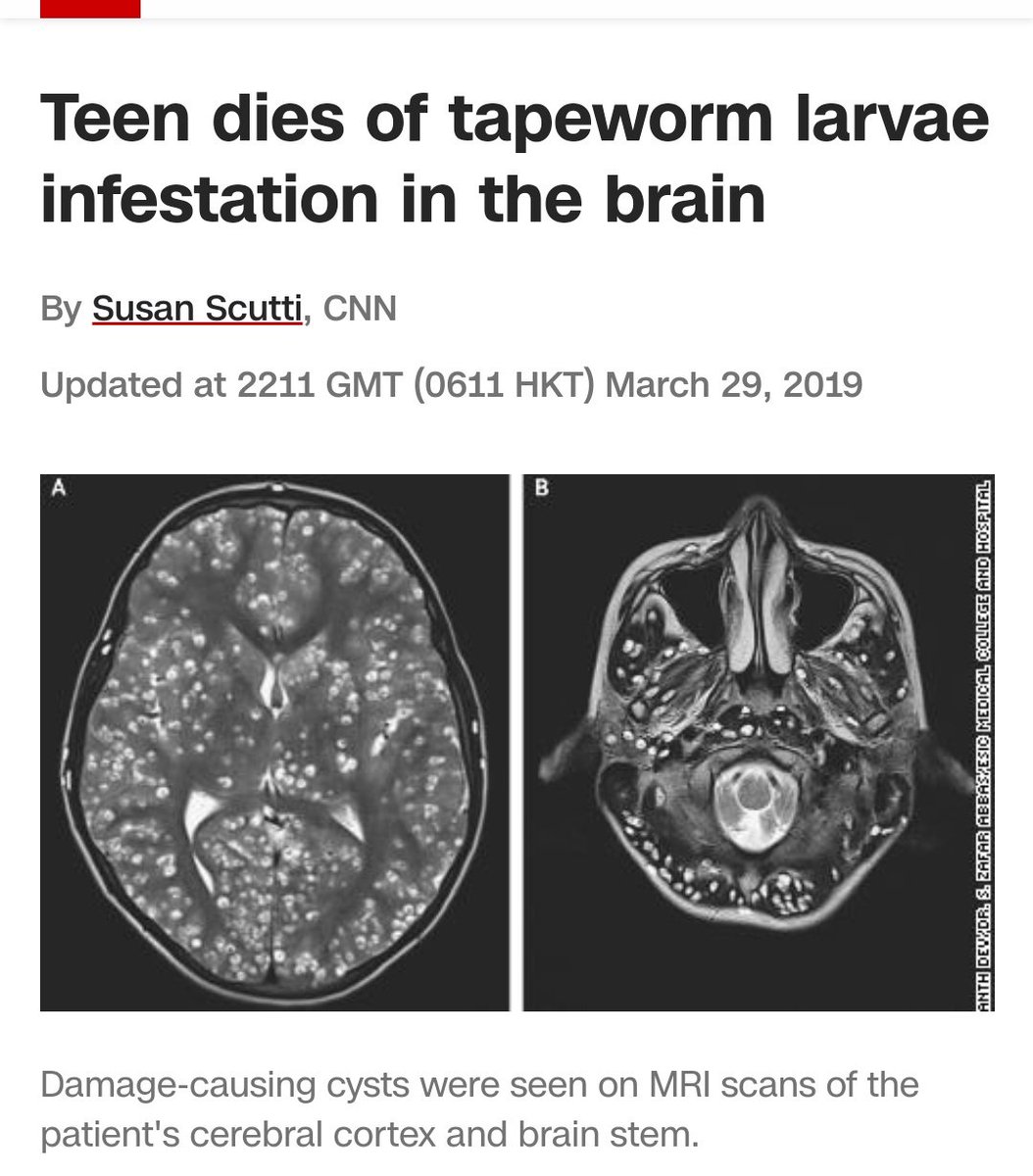 Tapeworms In The Brain