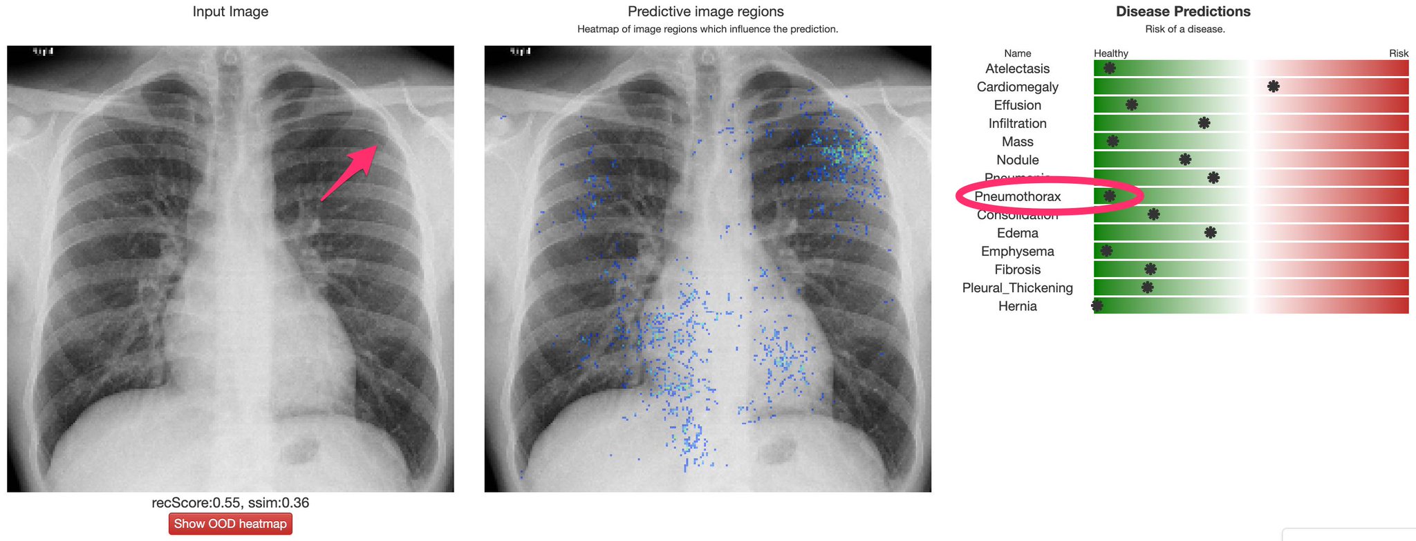 Apical Pneumothorax Chest X Ray