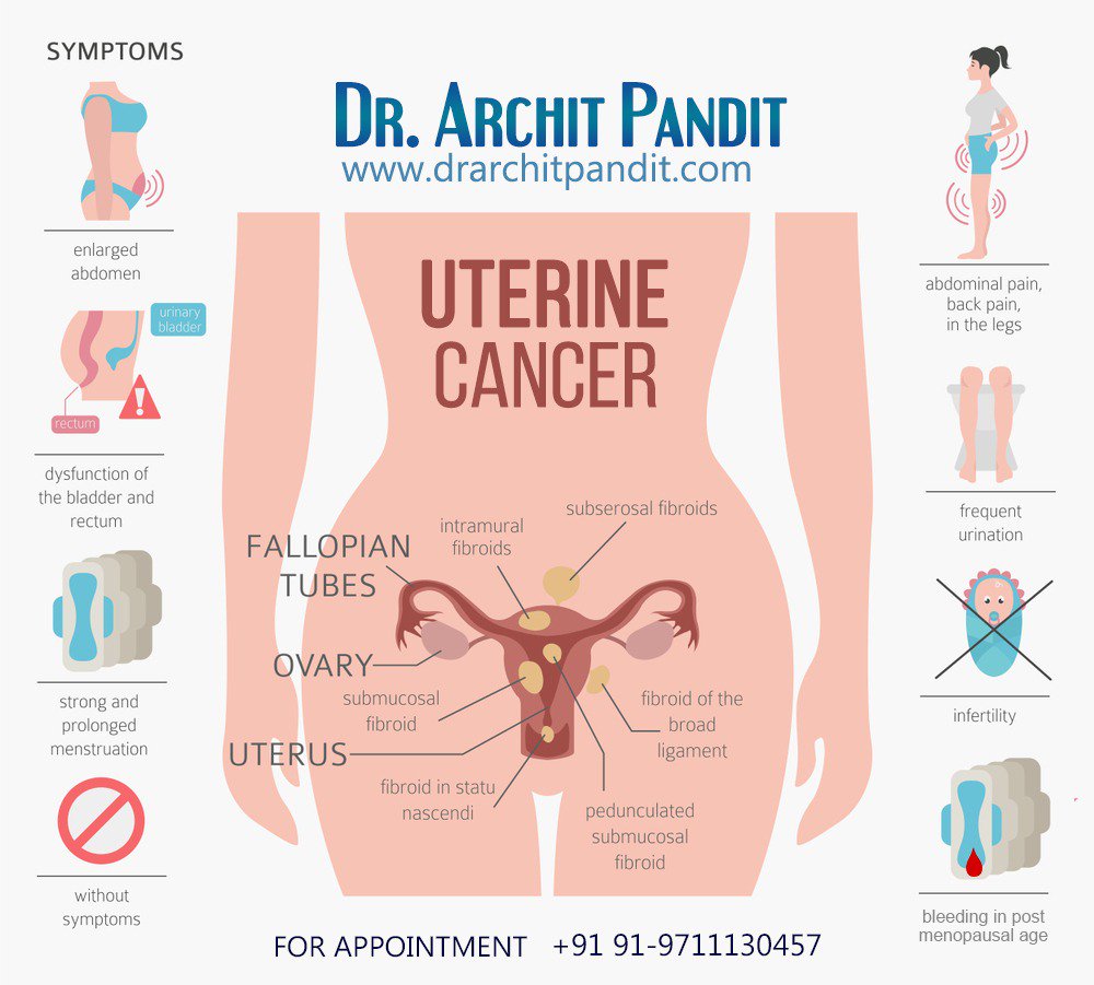 Endometrial Cancer Types Symptoms Diagnosis Prevention