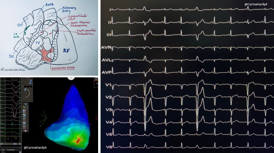 Moderator Band Diagram