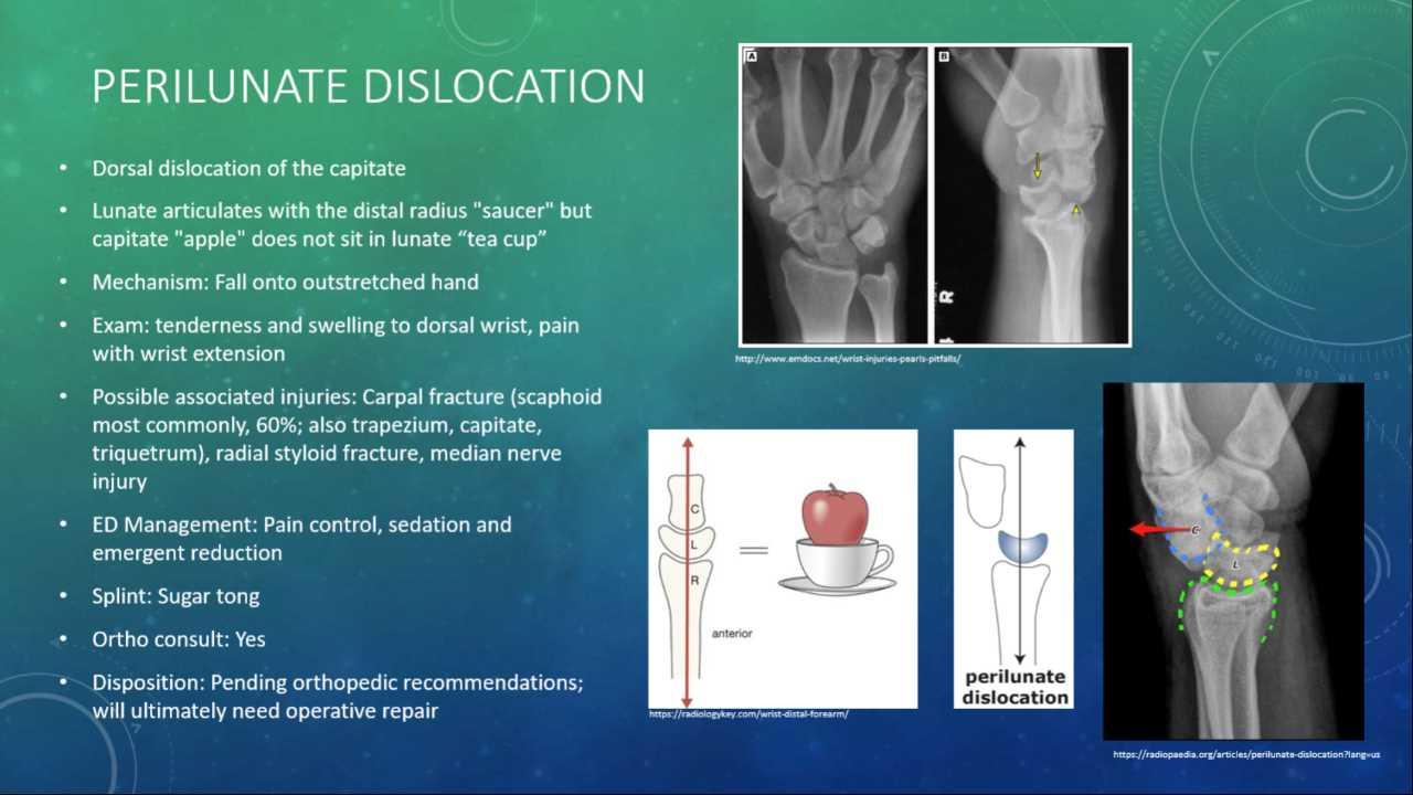 Capitate Dislocation Treatment