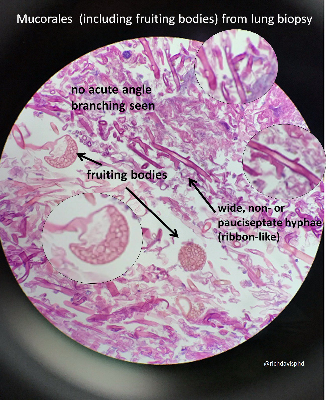 Aspergillus Histology