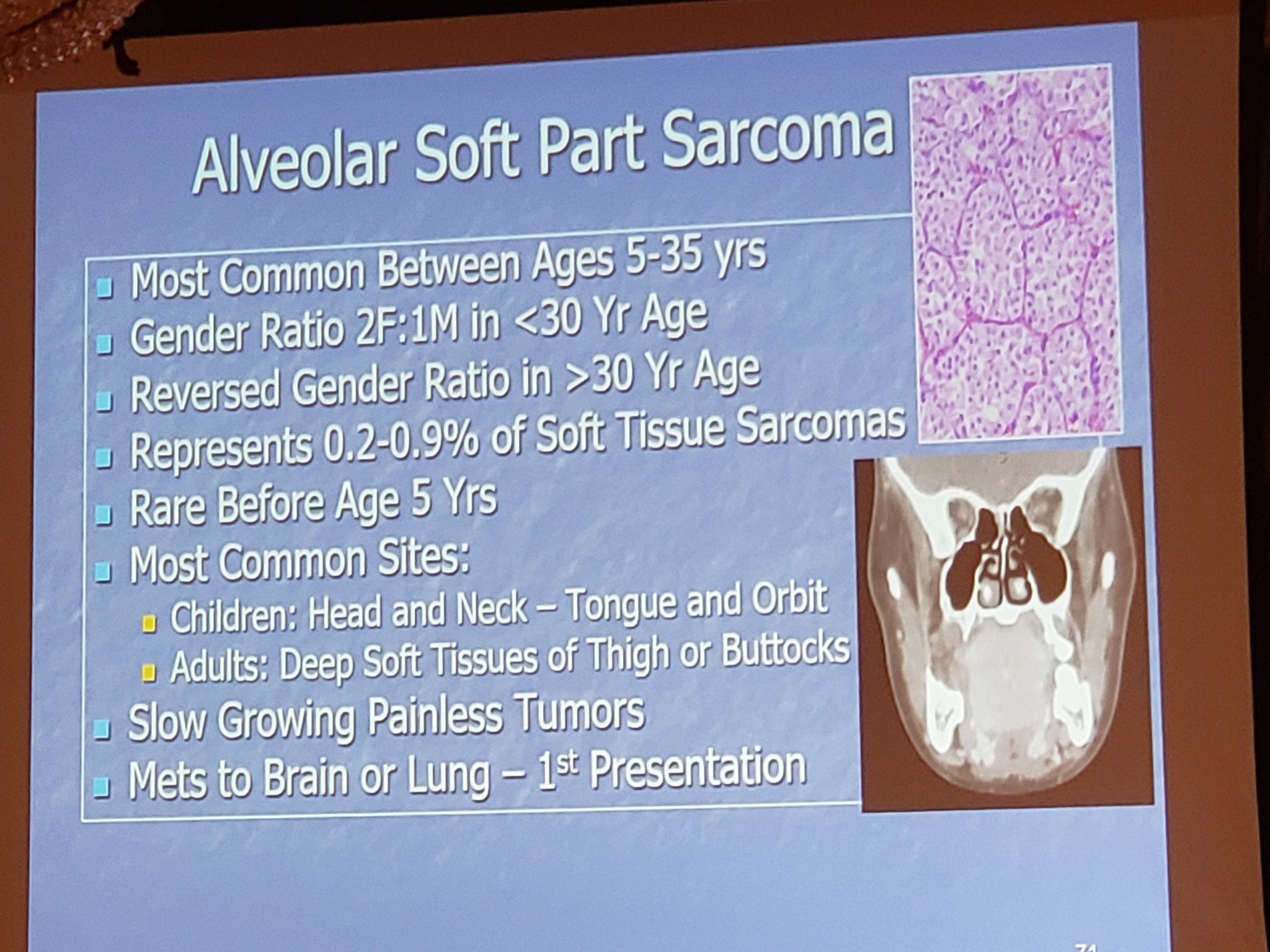 Alveolar Soft Part Sarcoma
