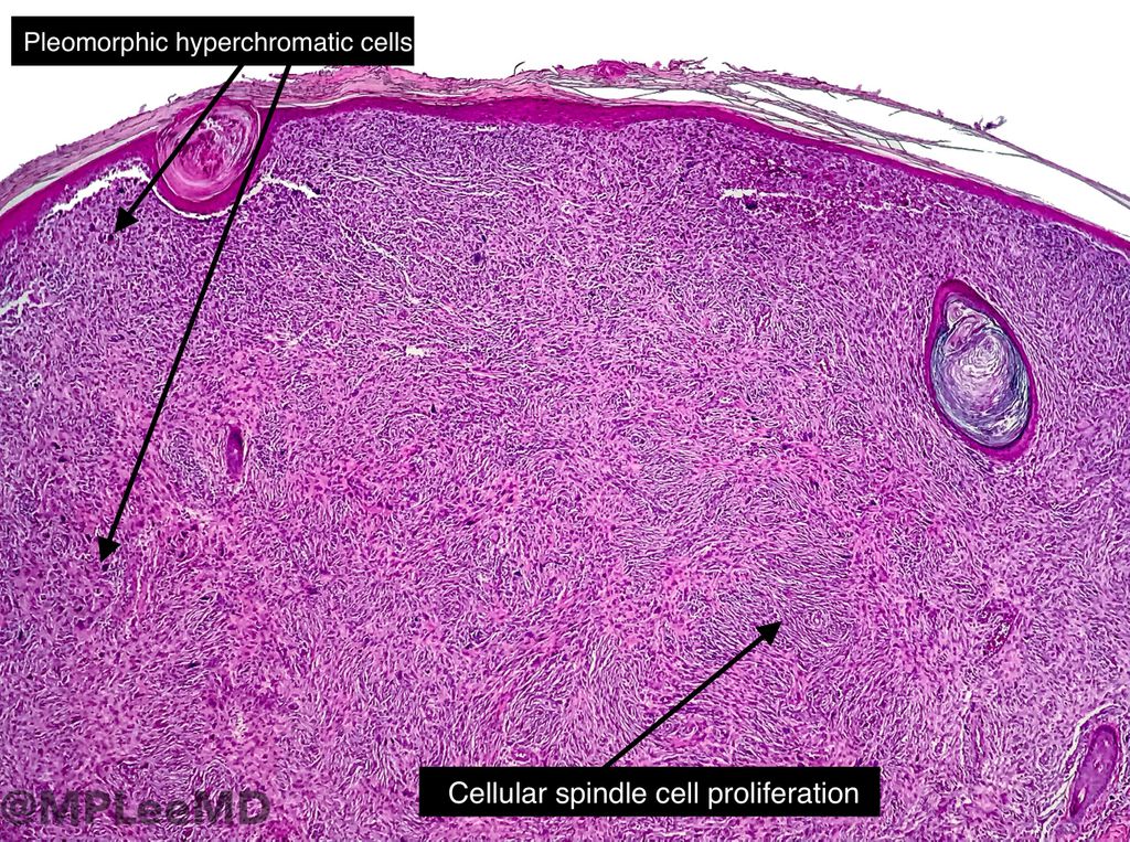 Atypical Fibroxanthoma Histology