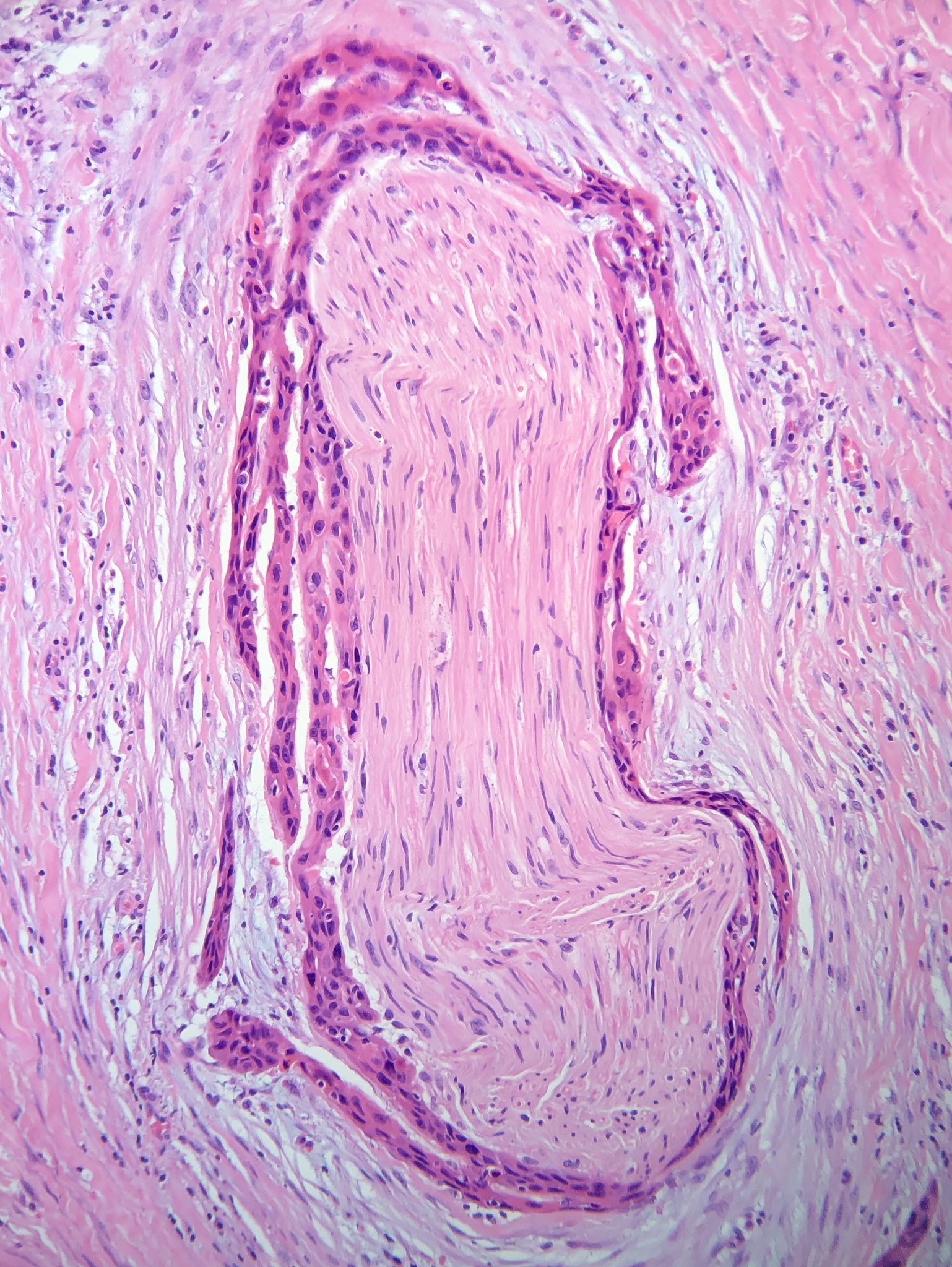 Esther Youd on Twitter: "Amazing examples of perineural invasion in skin squamous cell carcinoma ...