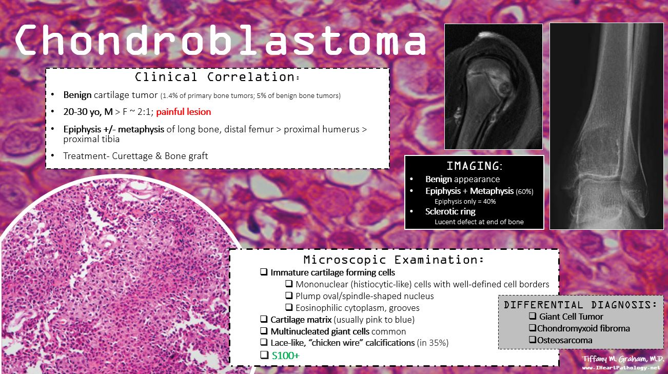 Chondroblastoma Pathology Outlines