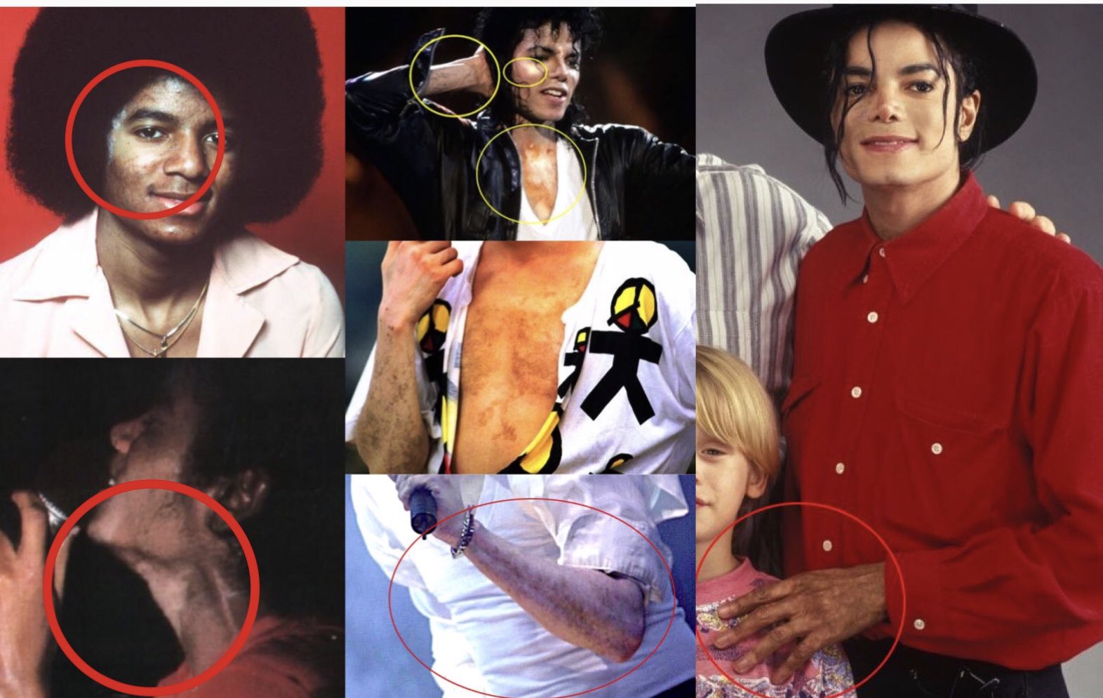 Vitiligo Michael Jackson