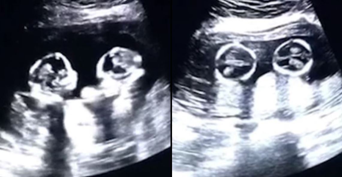 Identical Twins In The Womb