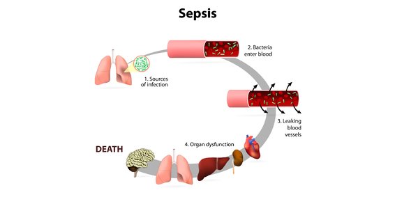 Best practices for sepsis and septic shock management in neutropenic ...