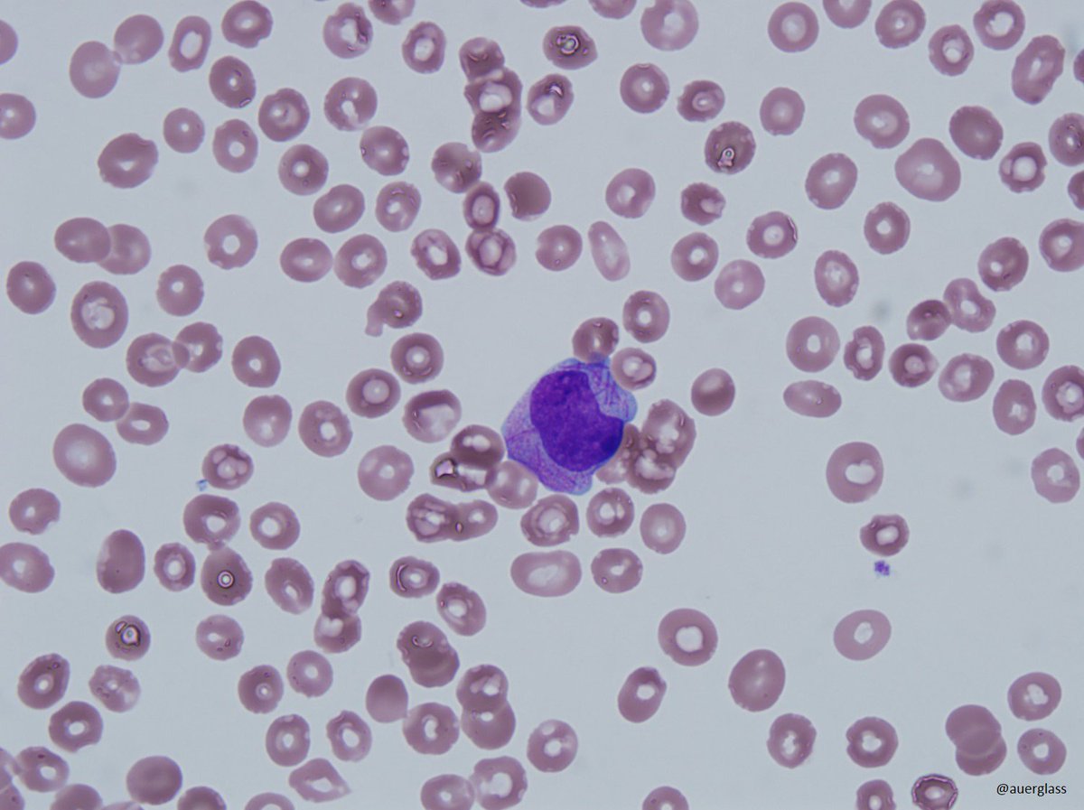 Acute Promyelocytic Leukemia Microgranular Variant