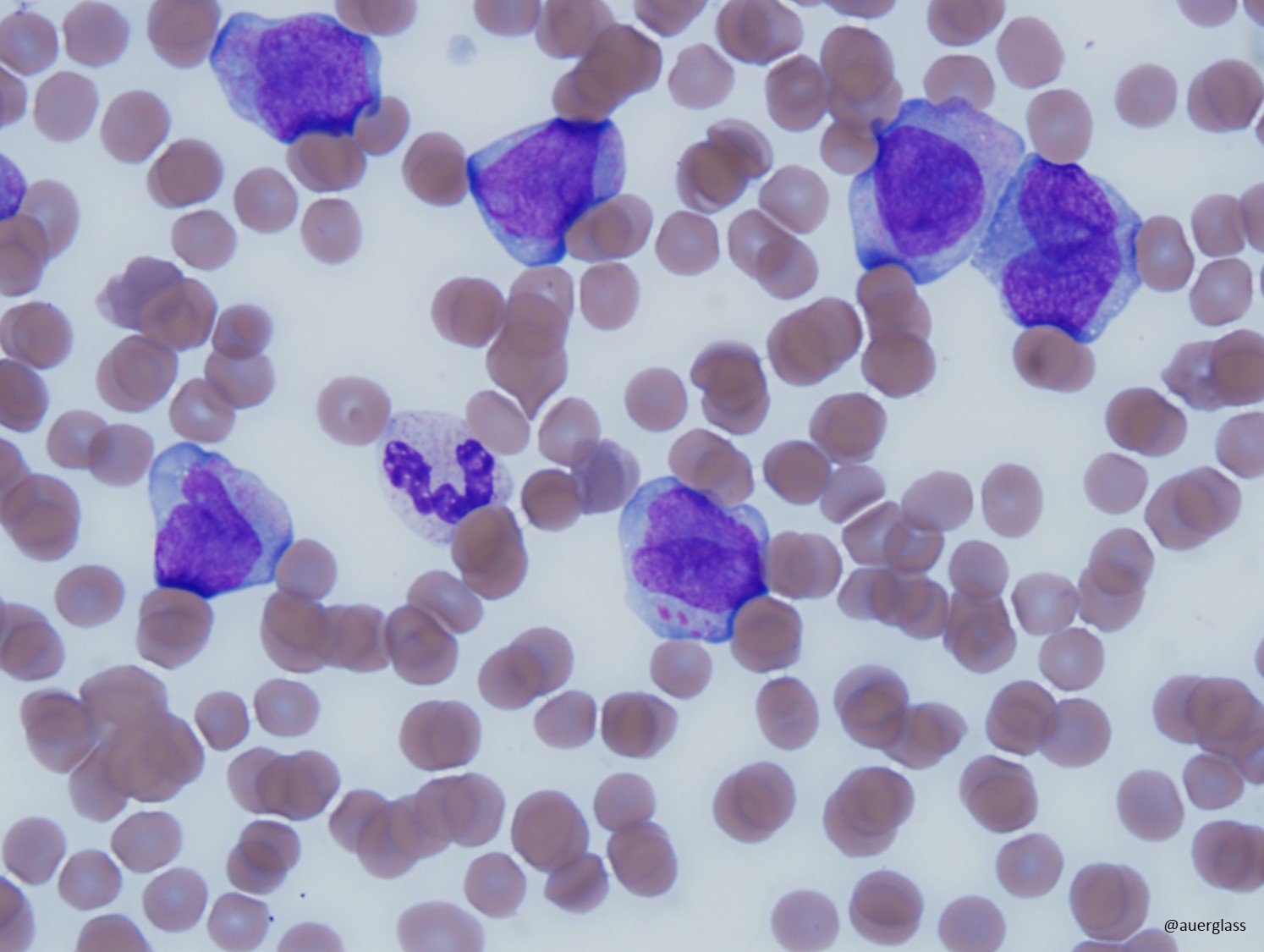 Acute Promyelocytic Leukemia