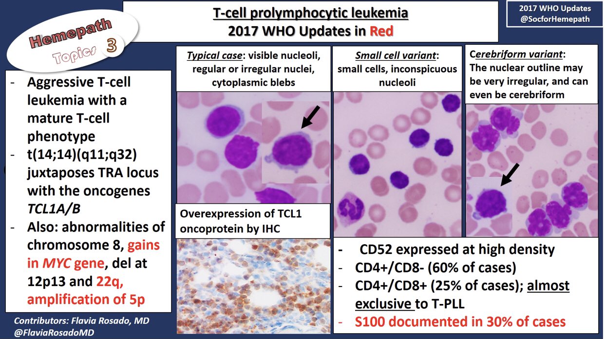 Prolymphocytic Leukemia (pll)