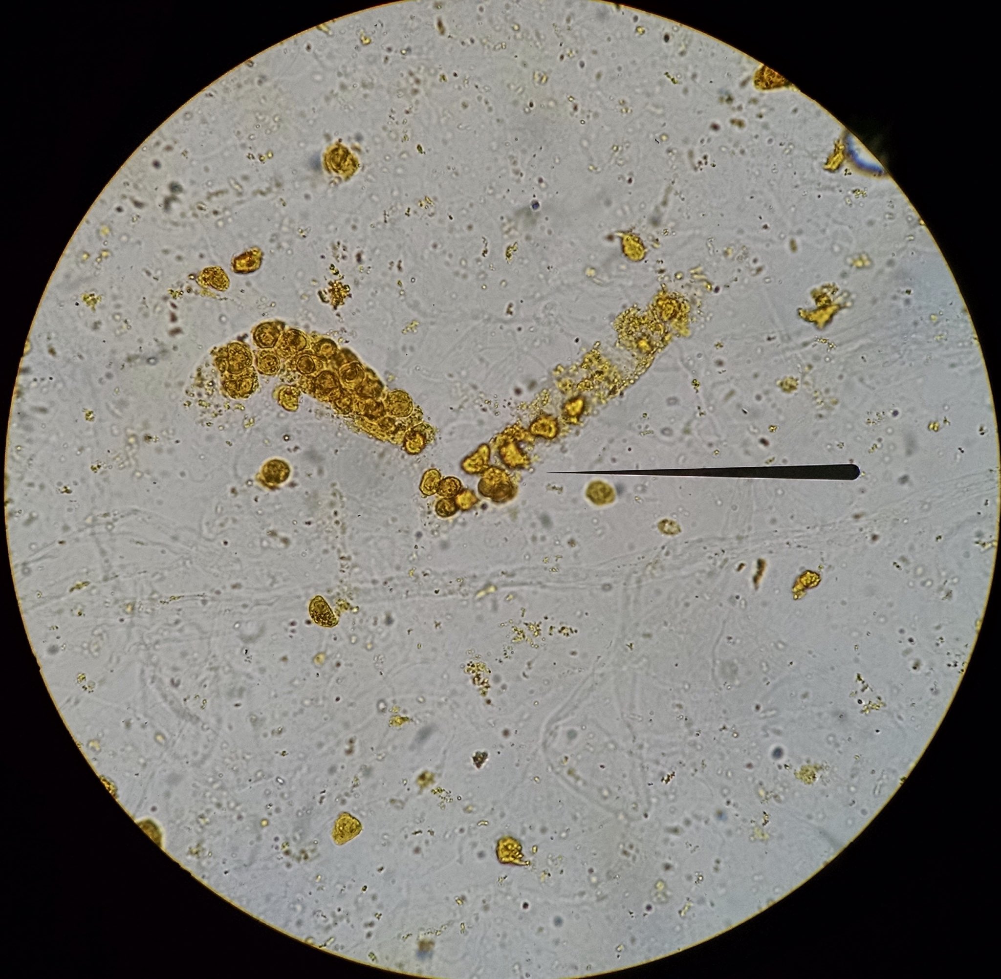 Casts In Urine Sediment Microscopic Analysis Of Urine | Faculty Of
