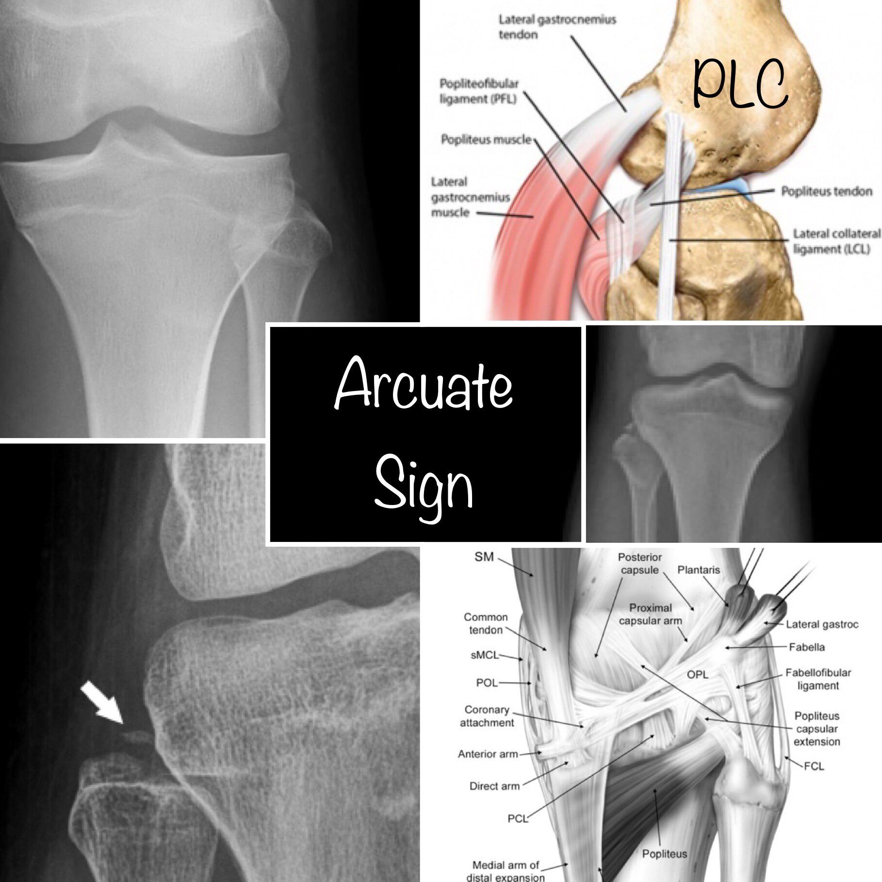 Popliteofibular Ligament