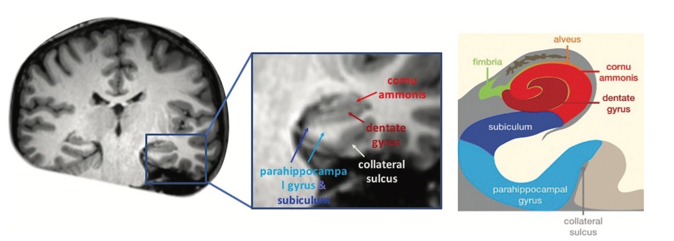 Parahippocampal Gyrus Mri