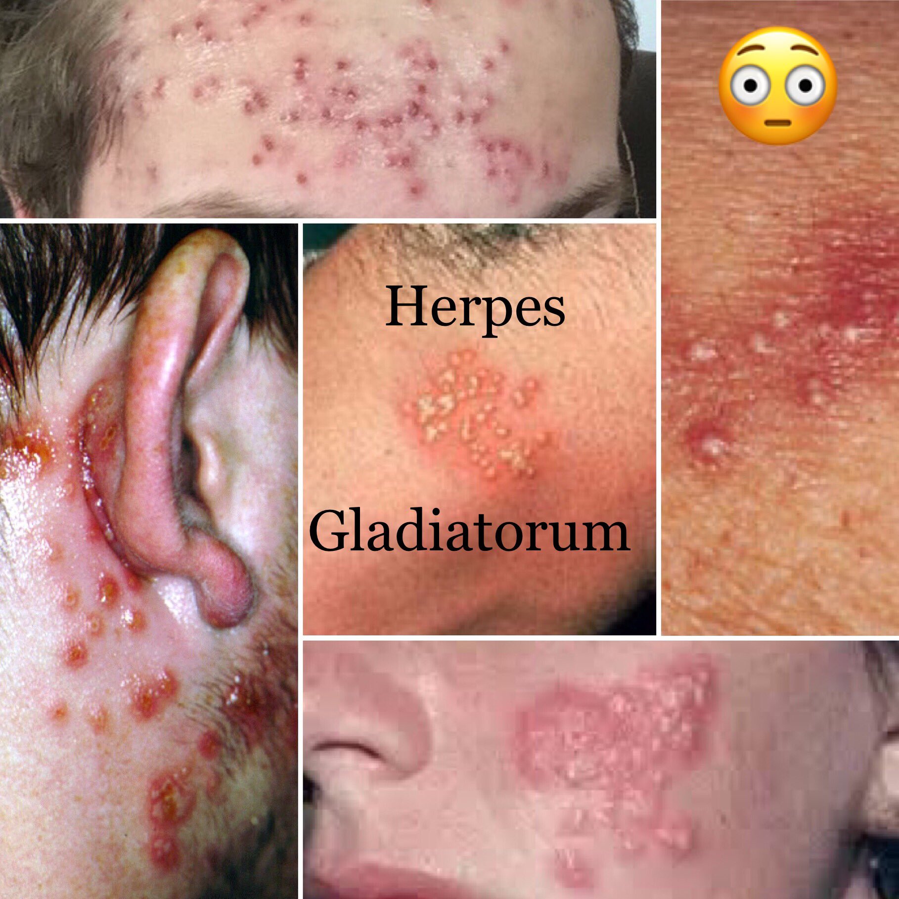 Herpes Gladiatorum