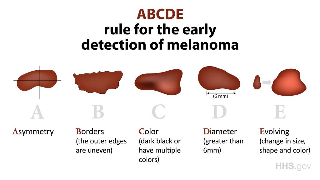 Malignant Melanoma Abcde
