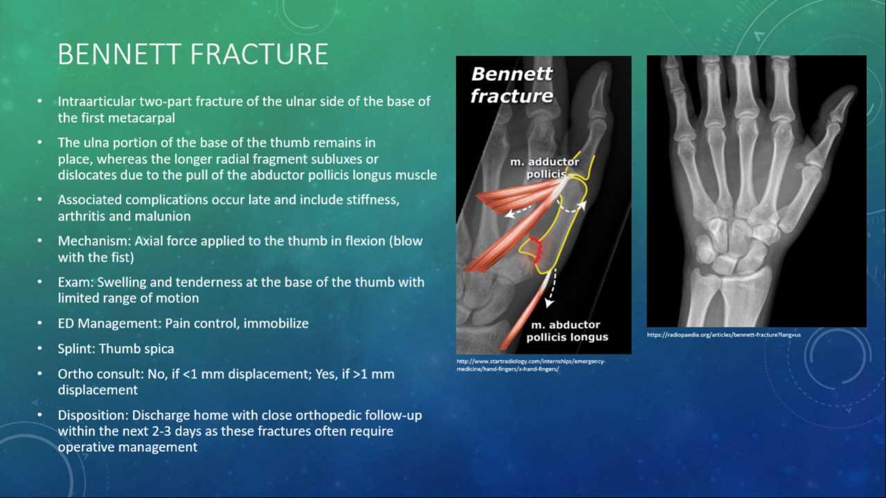 First Base Of Metacarpal