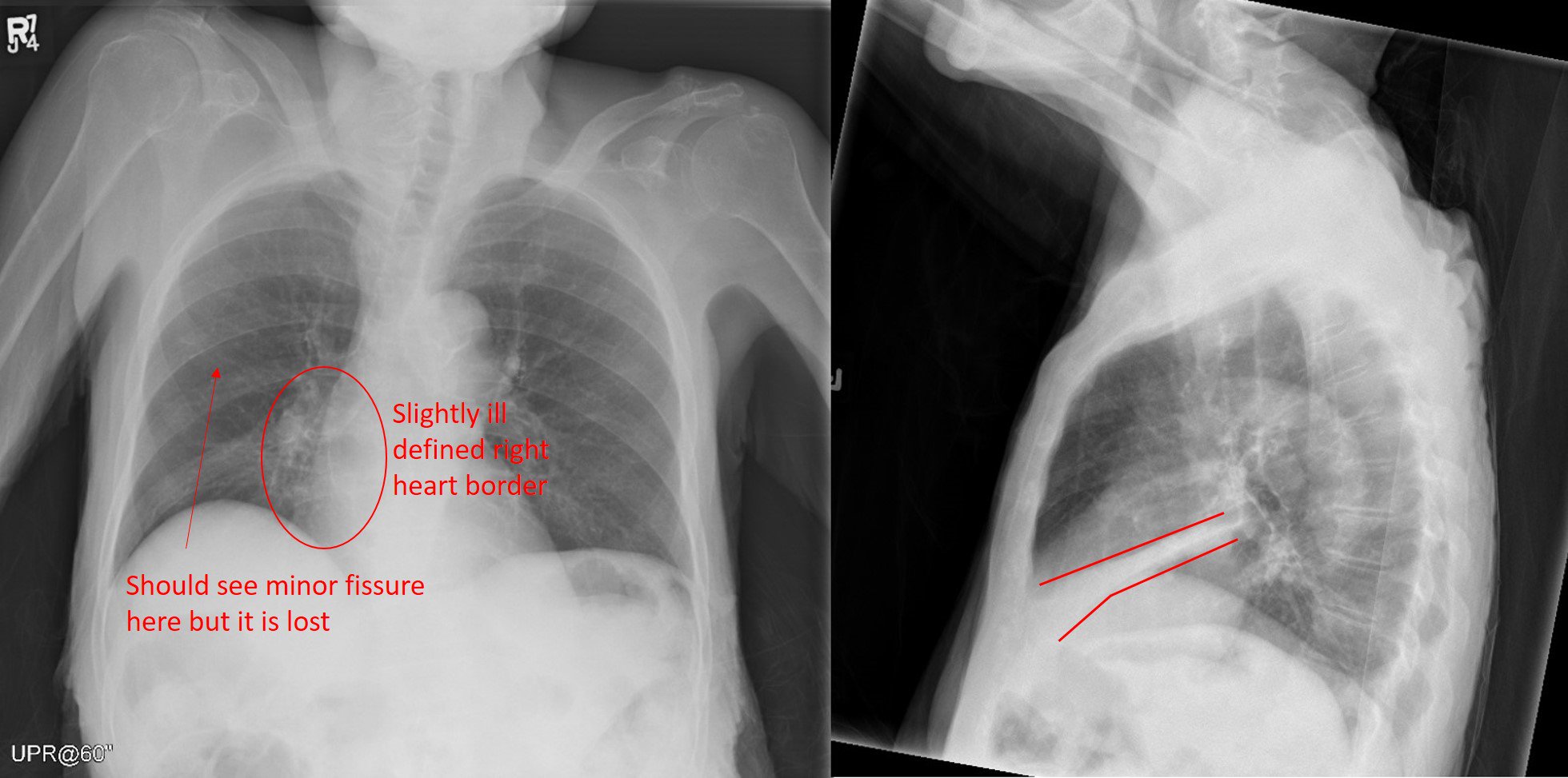 Right Middle Lobe Collapse X Ray
