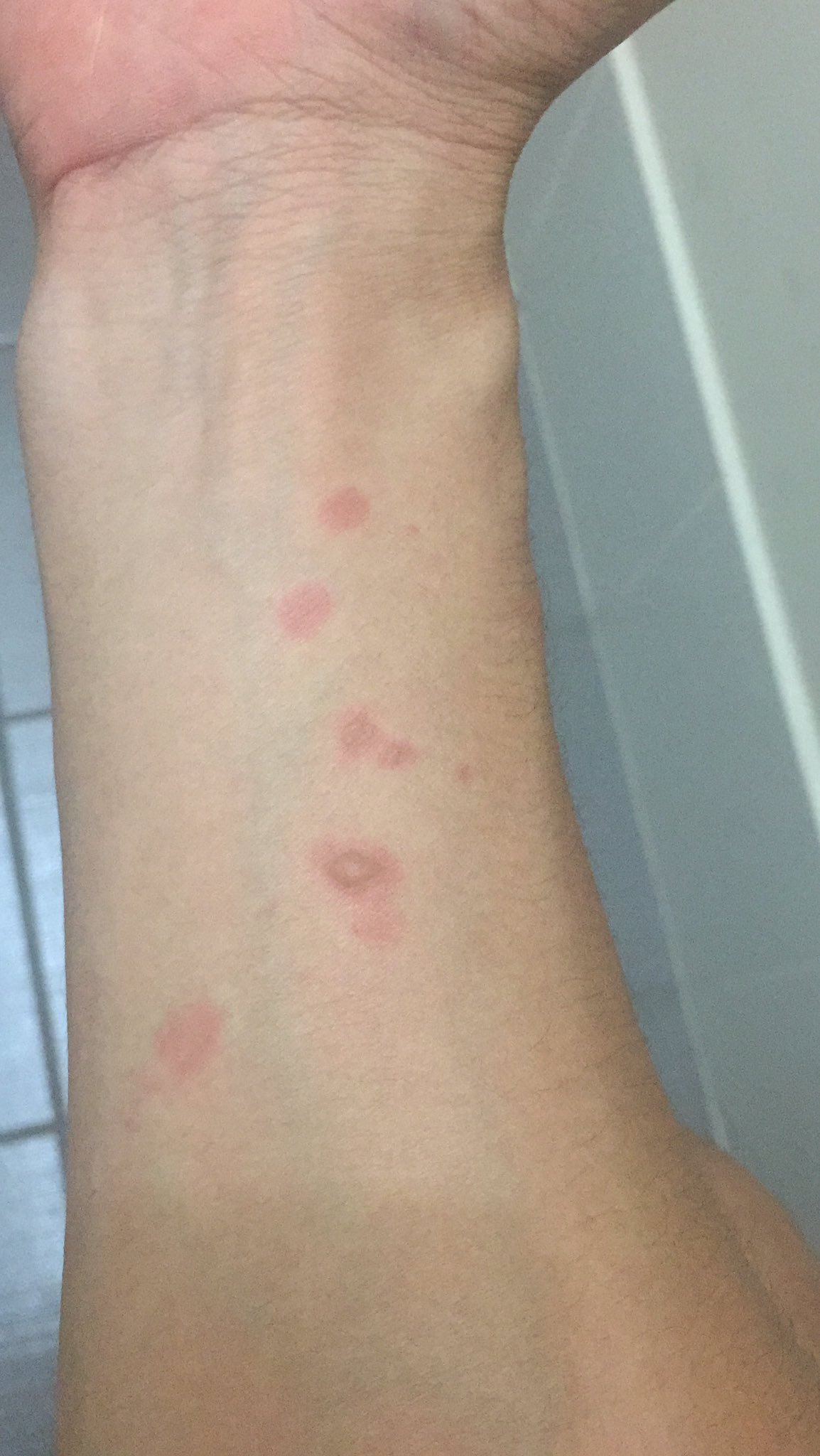 Herpes On Elbow