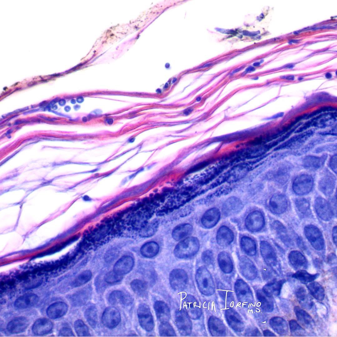 Confluent And Reticulated Papillomatosis Pathology
