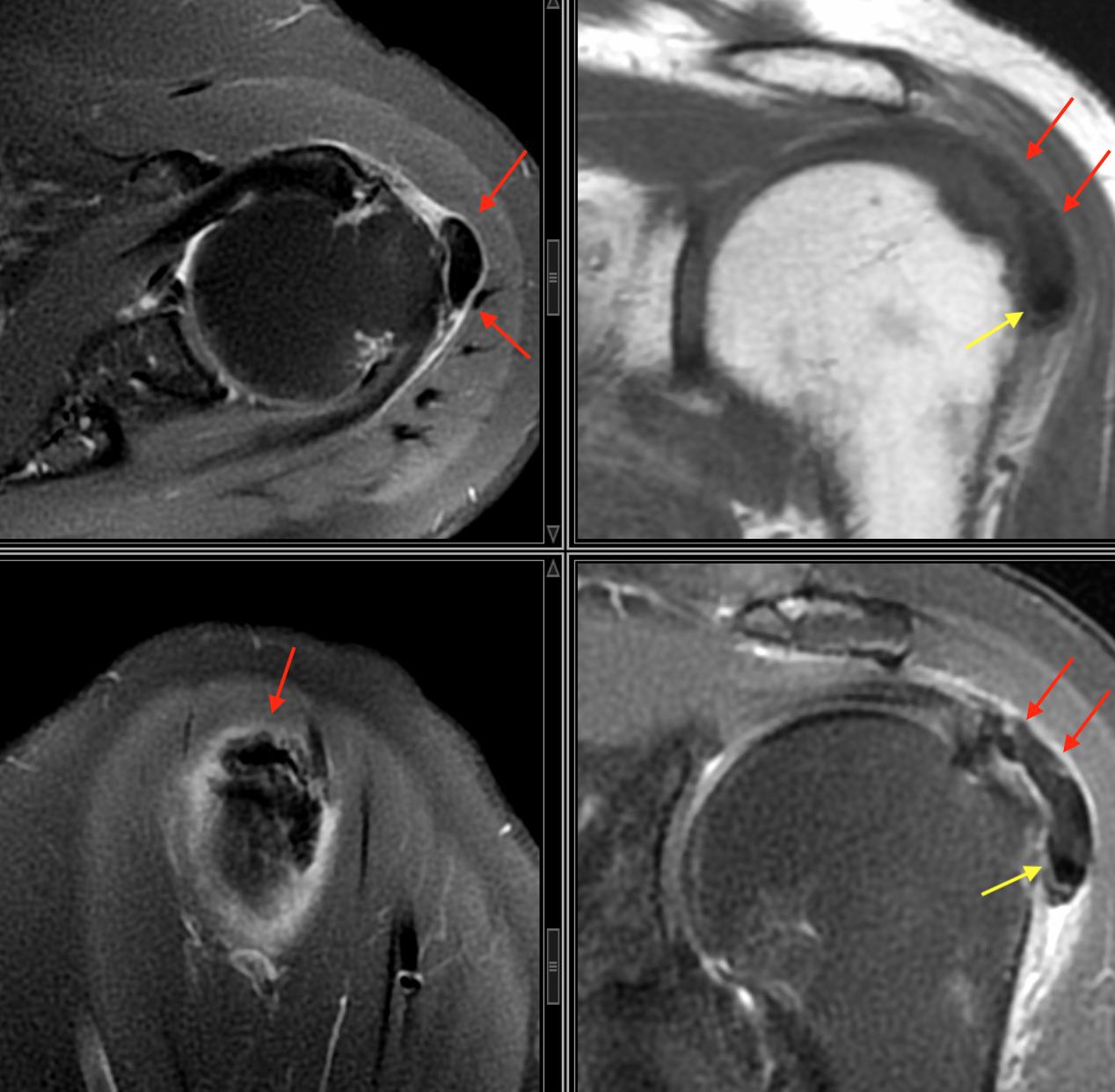 Subdeltoid Bursitis Mri Magnetic Resonance Imaging Of The Shoulder