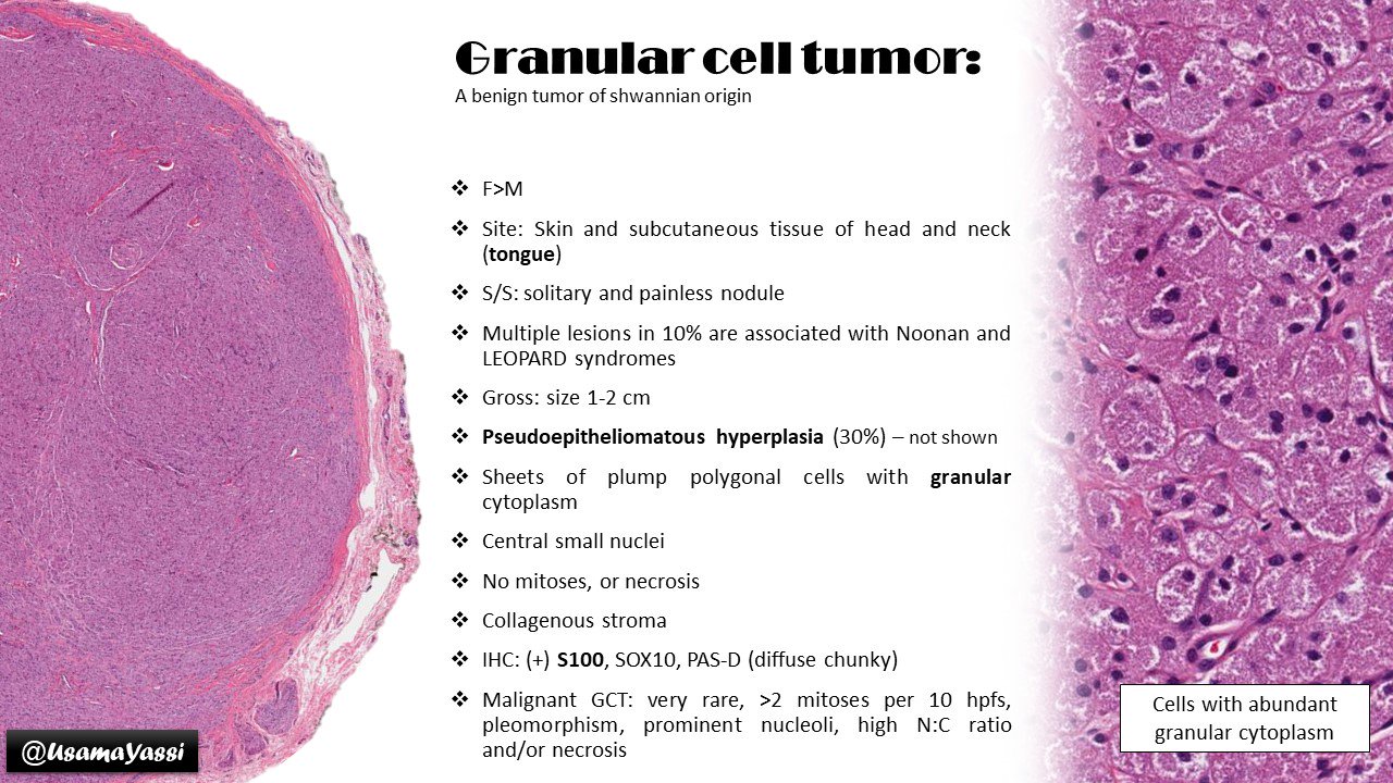 Granular Cell Tumor Histology Granules In Granular Cell Lesions Of The