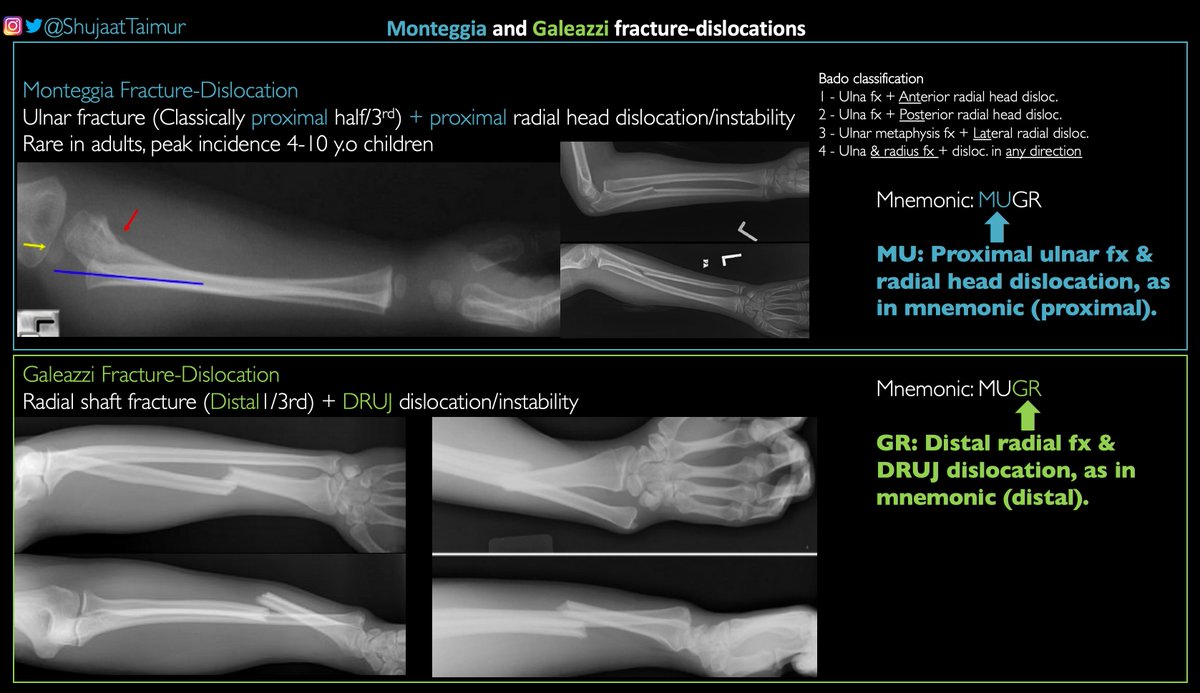 Difference between monteggia and galeazzi fracture - seryalpine