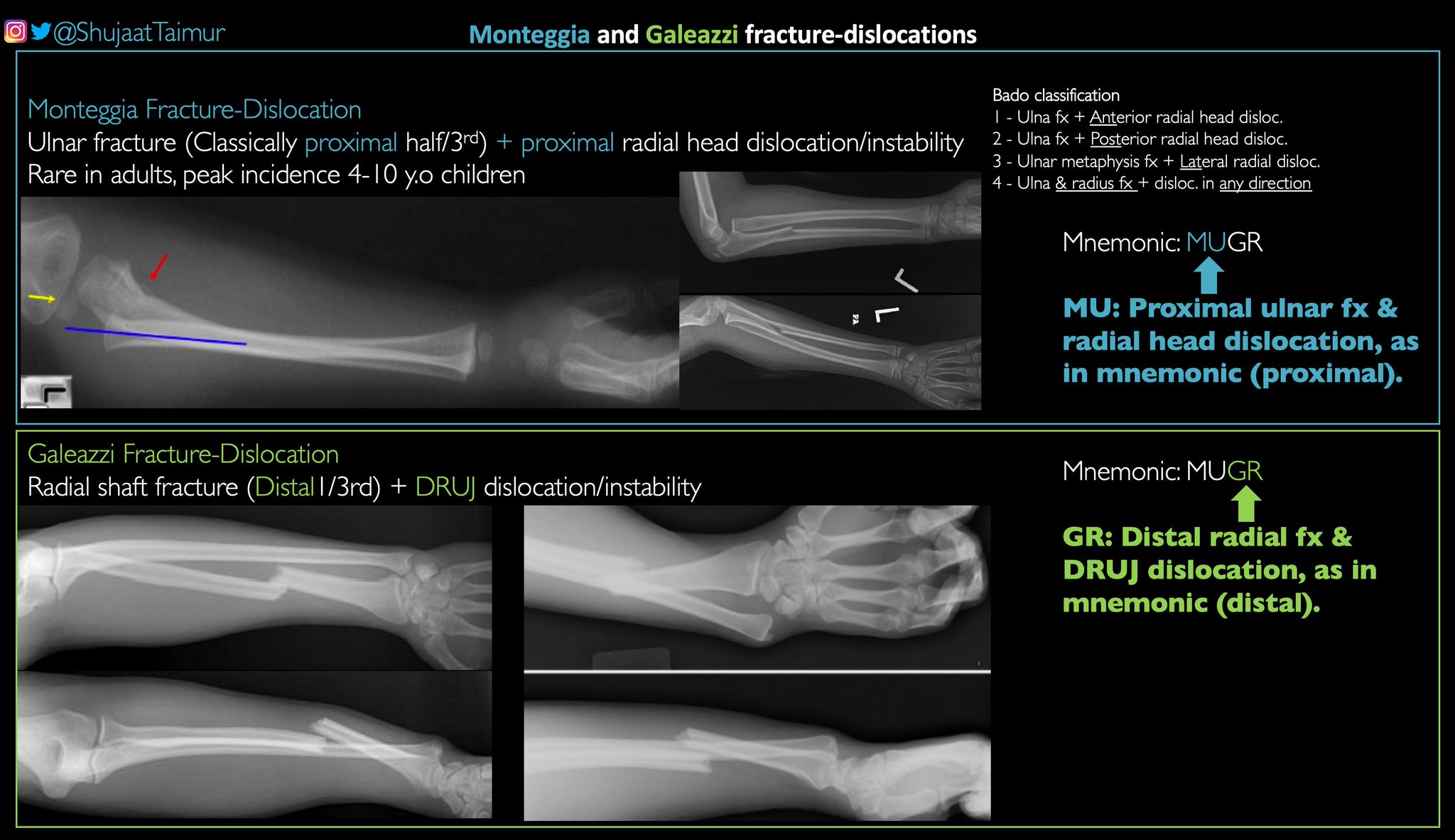Galeazzi Fracture Classification