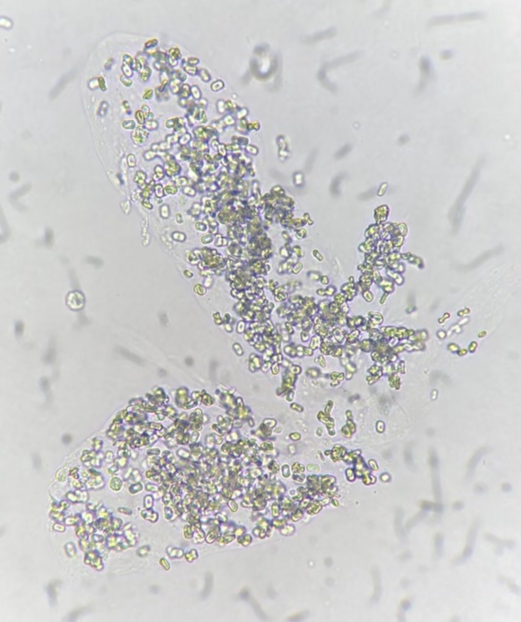 Calcium Oxalate Monohydrate Crystals In Urine