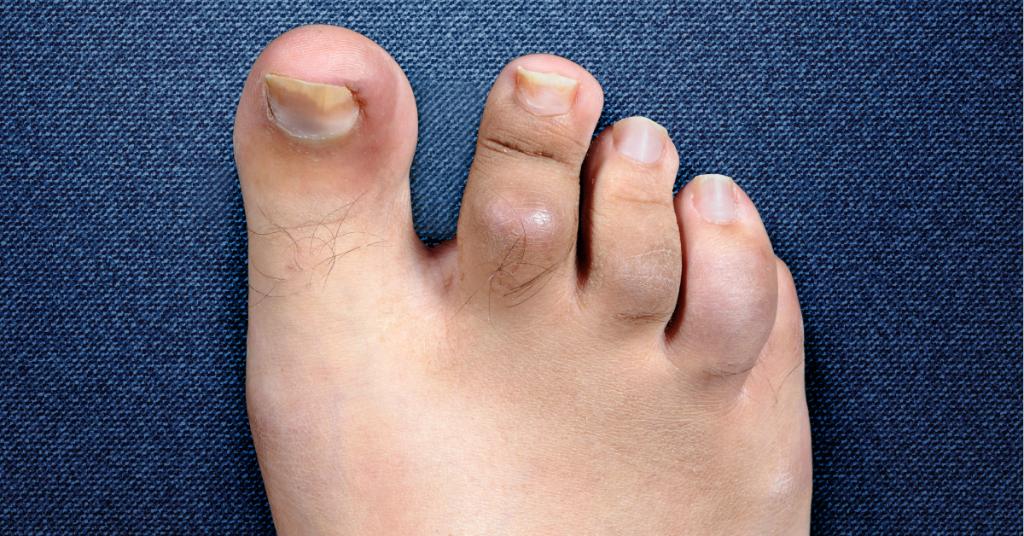 Psoriatic Arthritis Toes