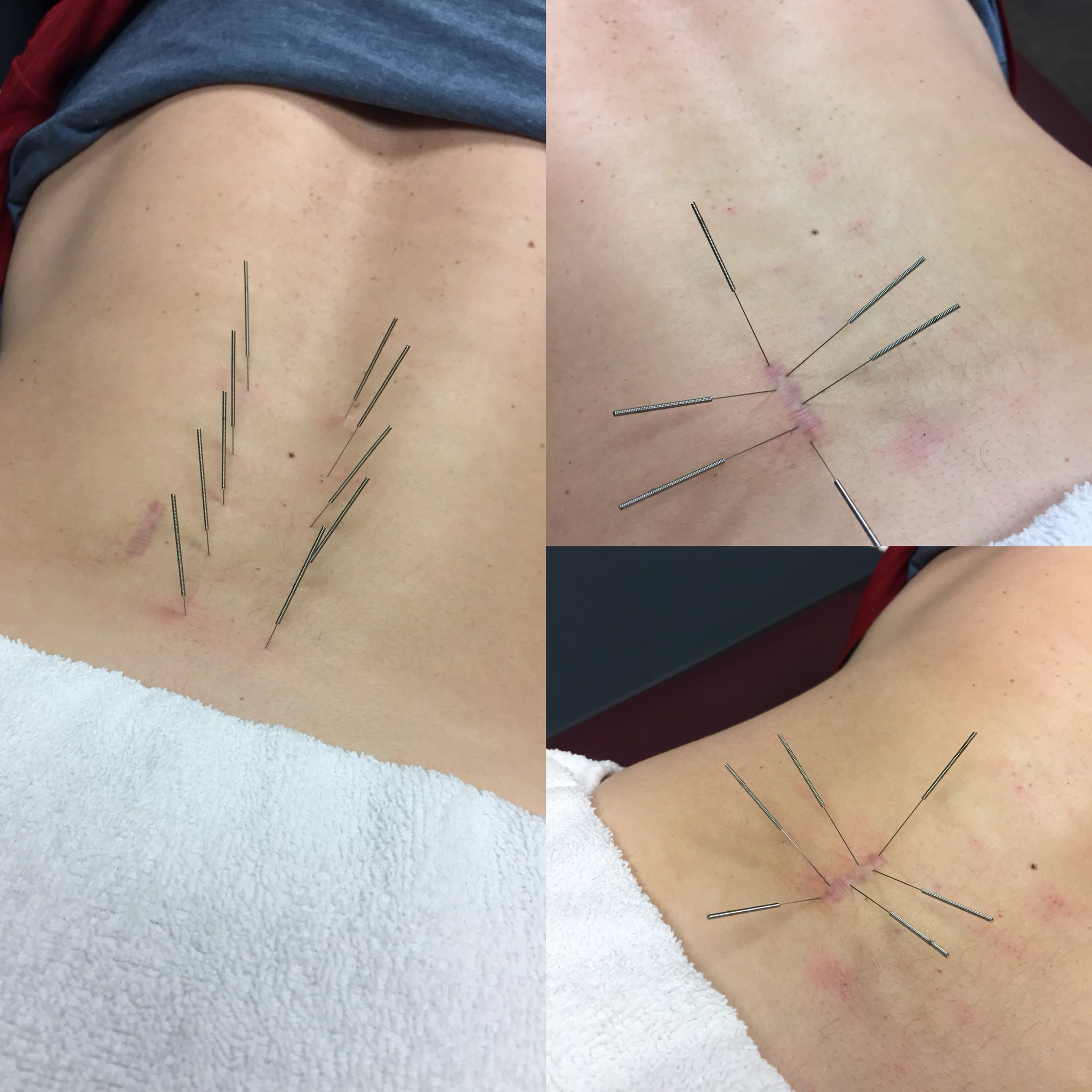 Microdiscectomy Scar