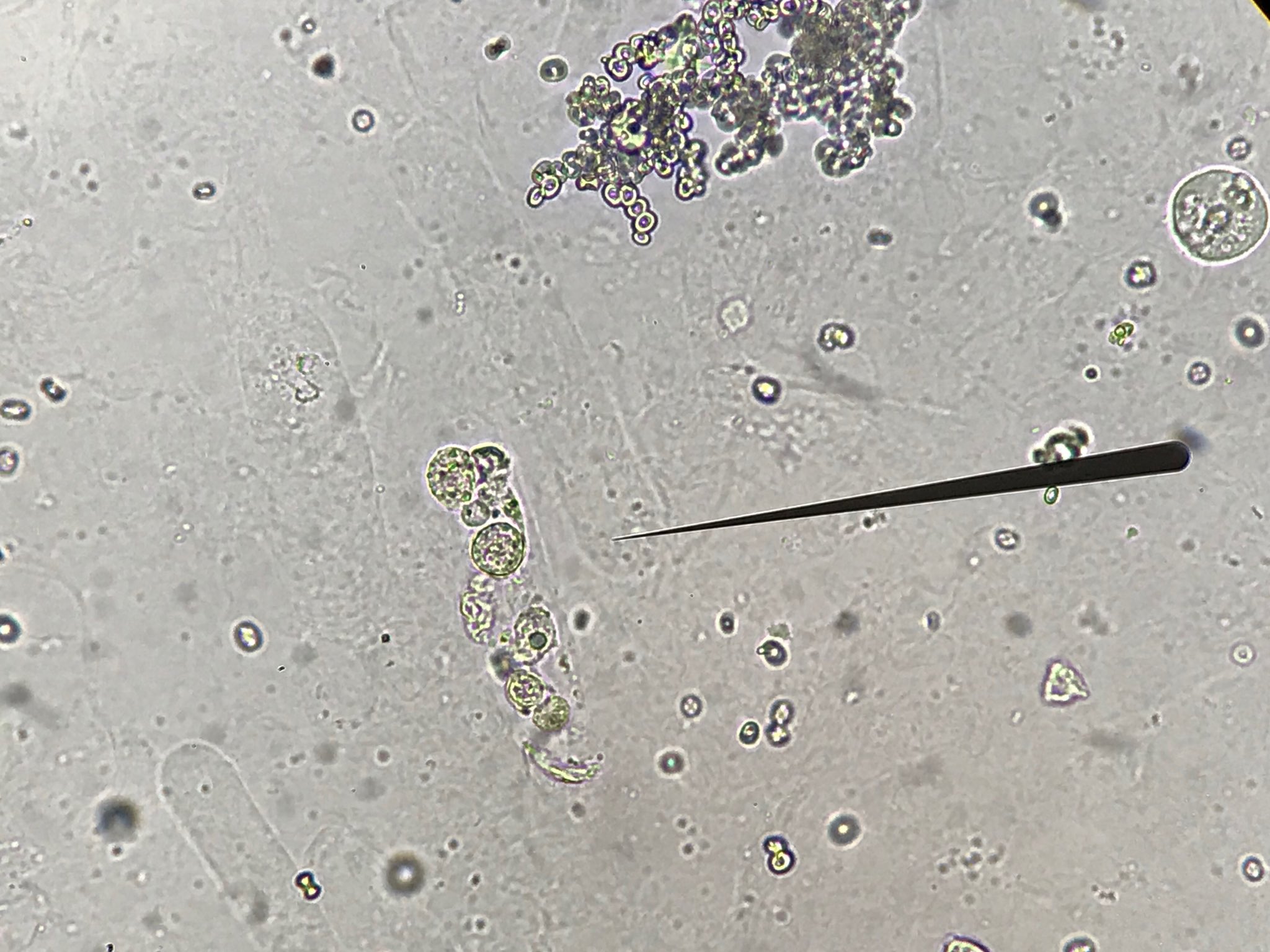 Epithelial Cell Cast In Urine